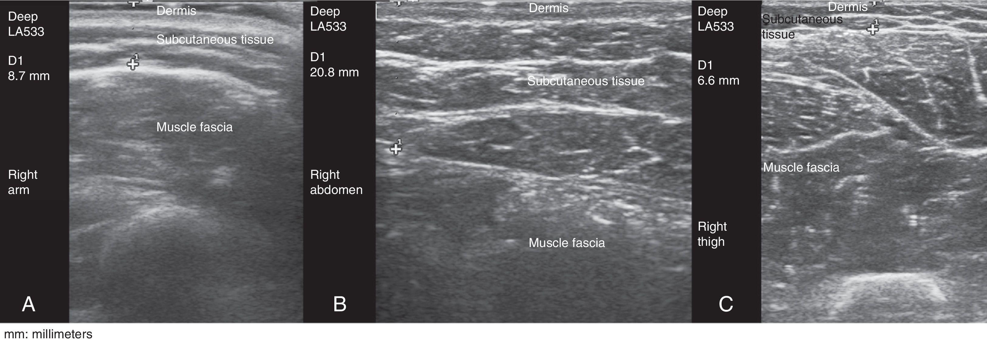 Impact of the Thickness of the Subcutaneous Tissue at the Site of ...