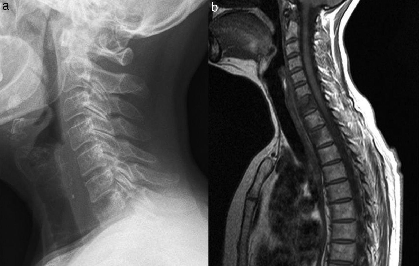 SAPHO Syndrome Presenting as an Osteolytic Lesion of the Neck ...
