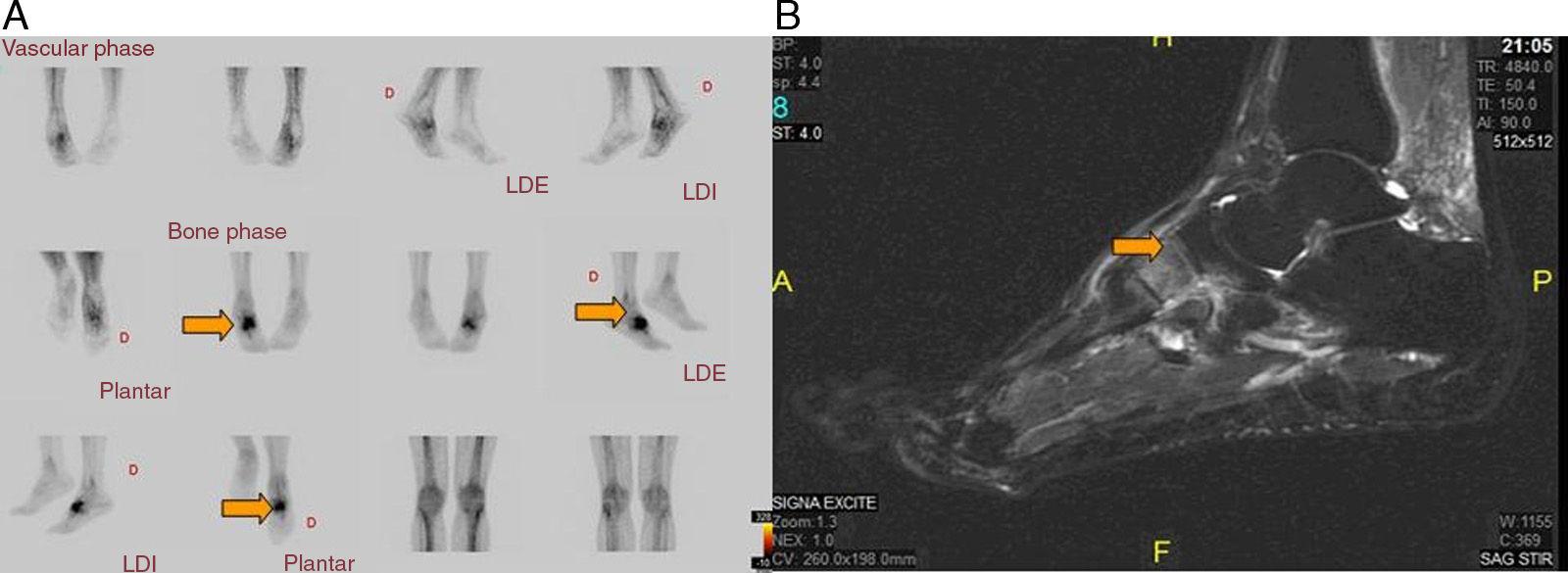 Recurrent Stress Fractures in the Feet of a Patient Treated With ...