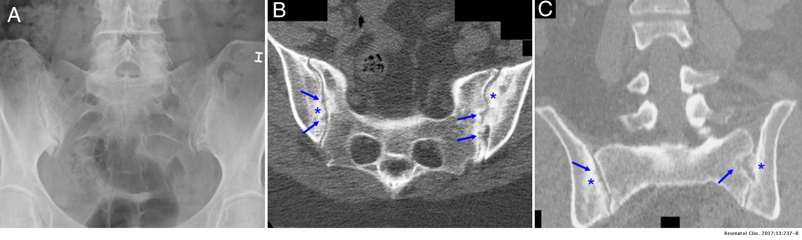 Ankylosing Spondylitis Pelvis X Ray