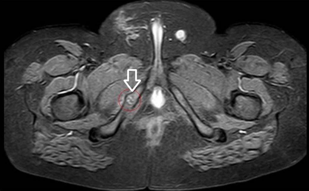 Van Neck-Odelberg Disease: Another Cause of Limp in Childhood ...