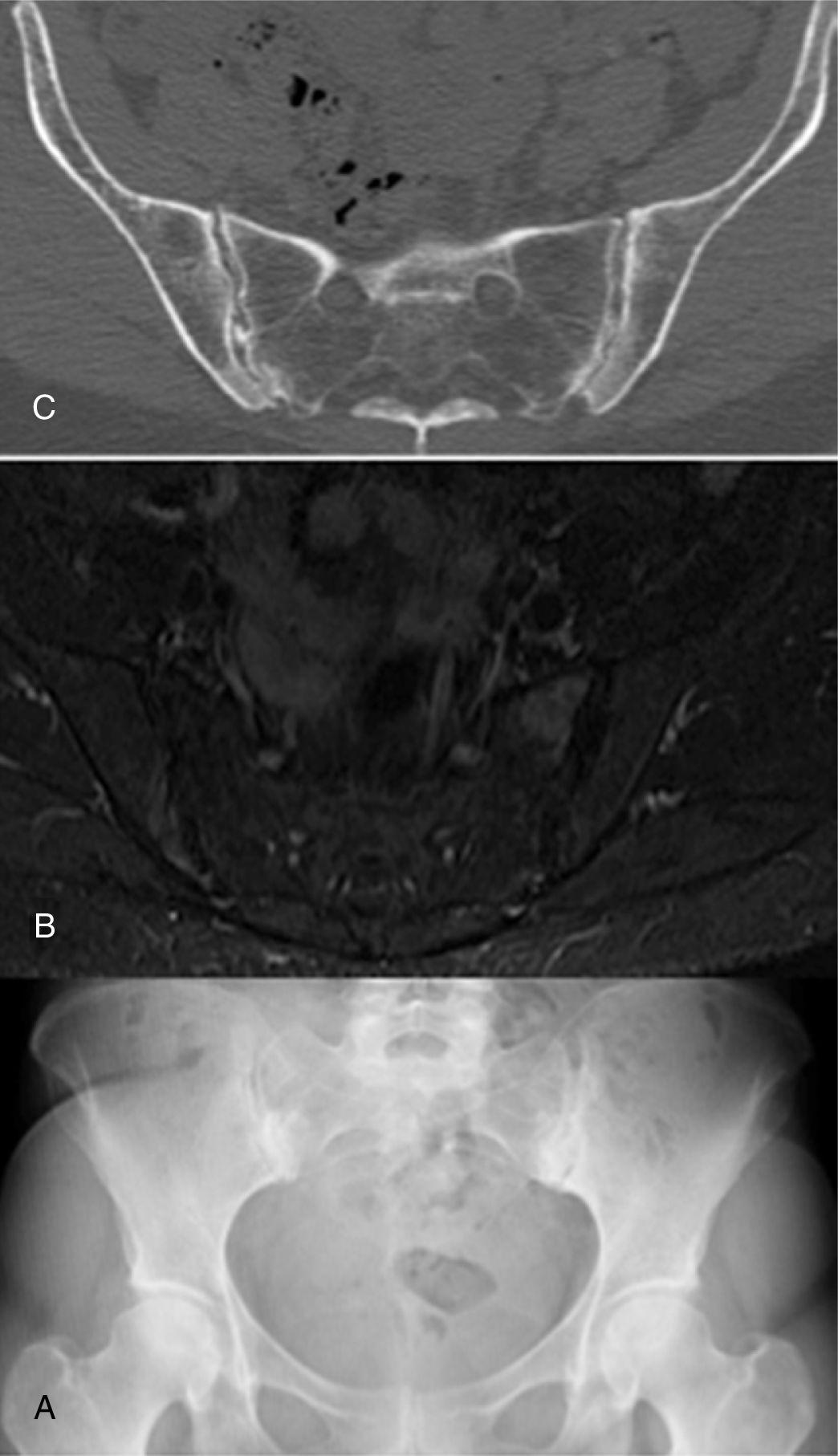 Sacroiliitis Due to Calcium Pyrophosphate Deposition Disease ...