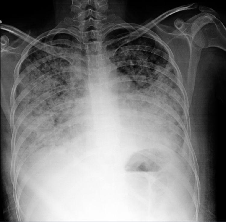 Pulmonary Manifestations in Systemic Lupus Erythematosus: Pleural ...
