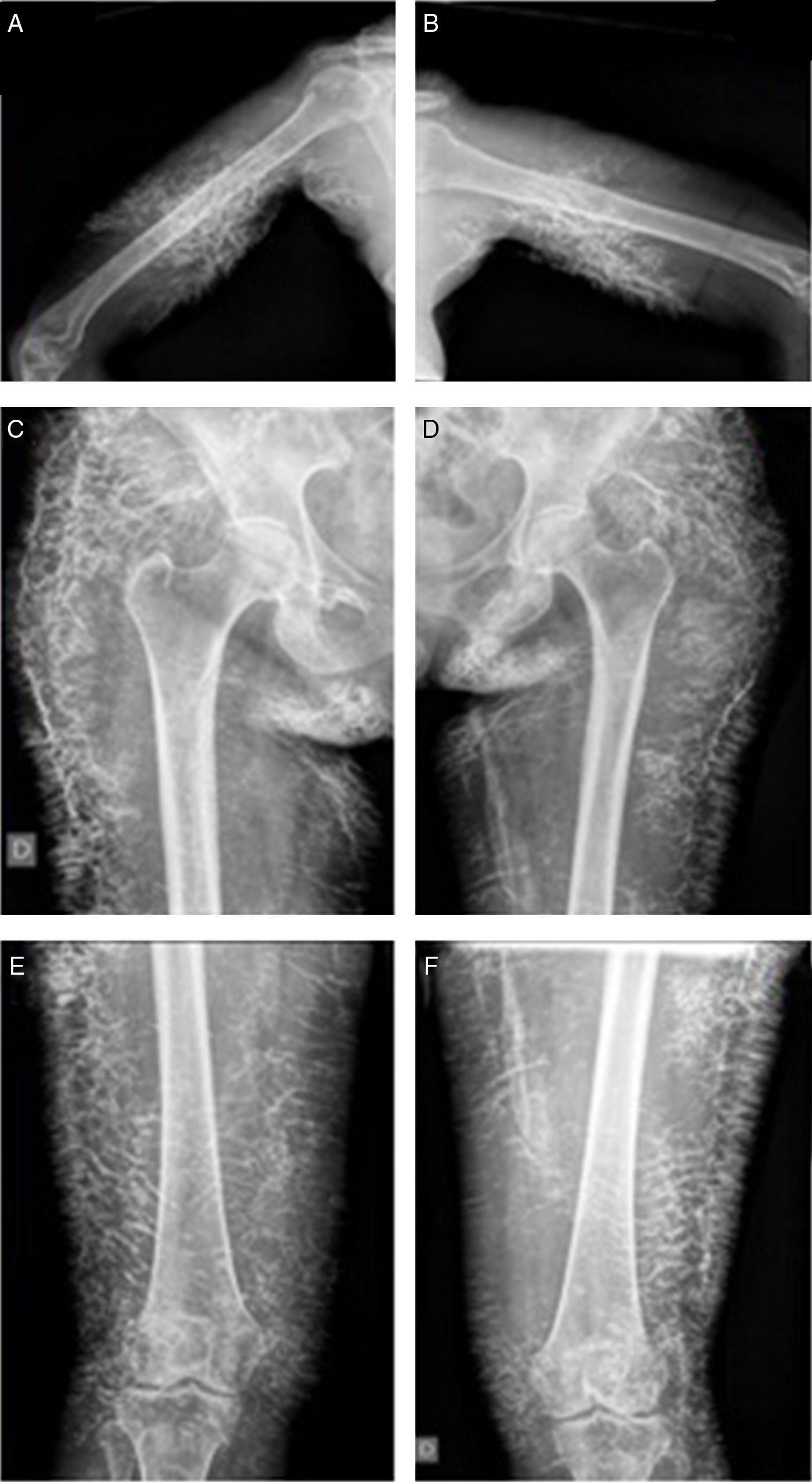Extensive Calcinosis in Adult Dermatomyositis | Reumatología Clínica