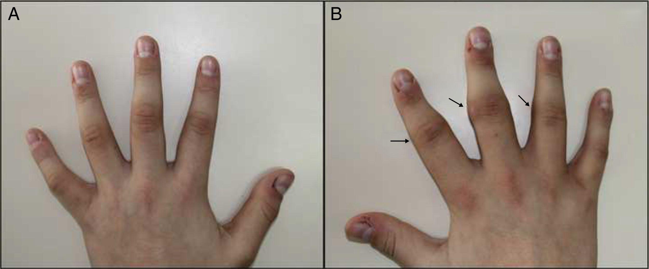 Pachydermodactyly: The great mimicker | Reumatología Clínica
