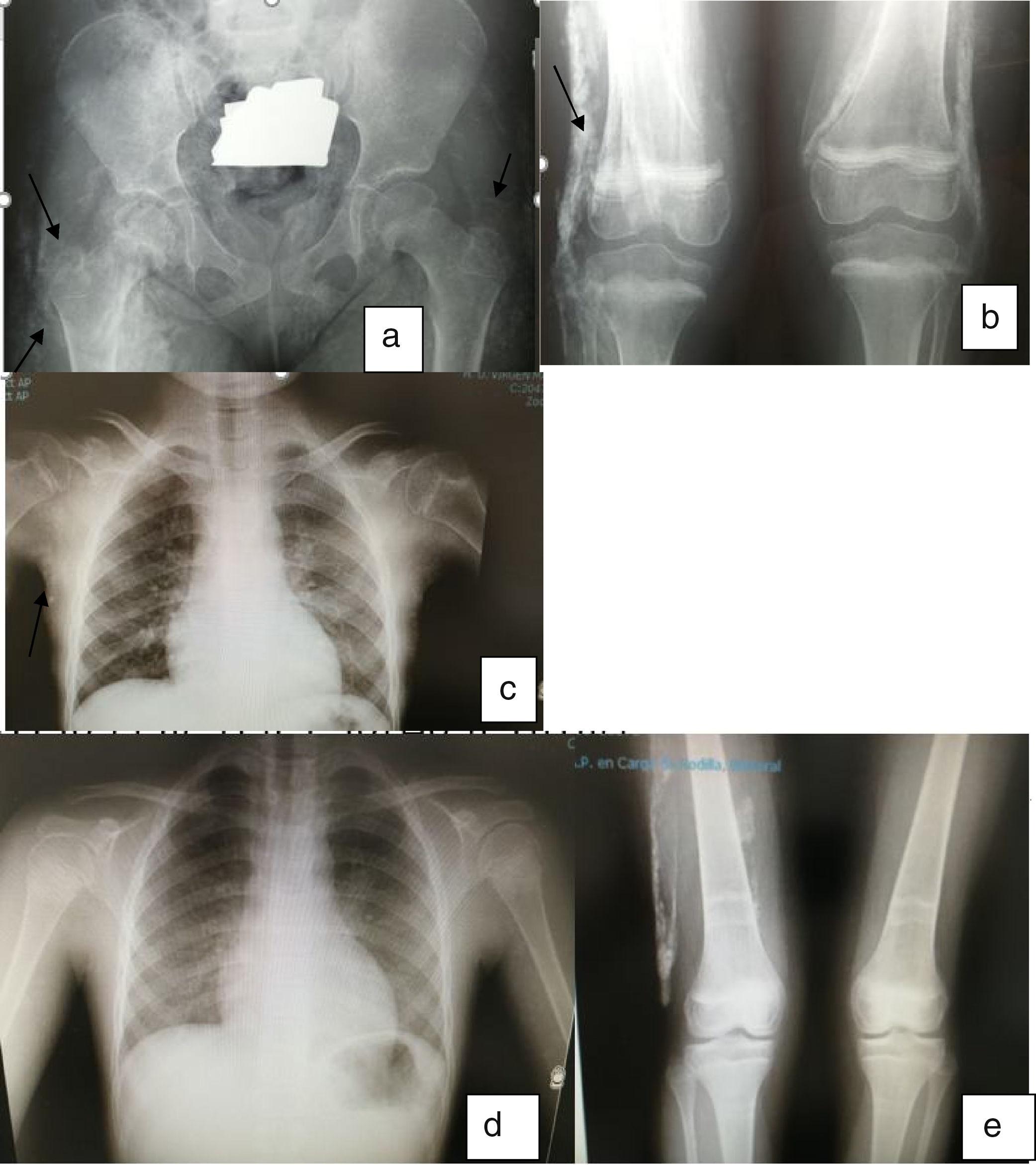 Treatment with rituximab in juvenile dermatomyositis: Effect on ...