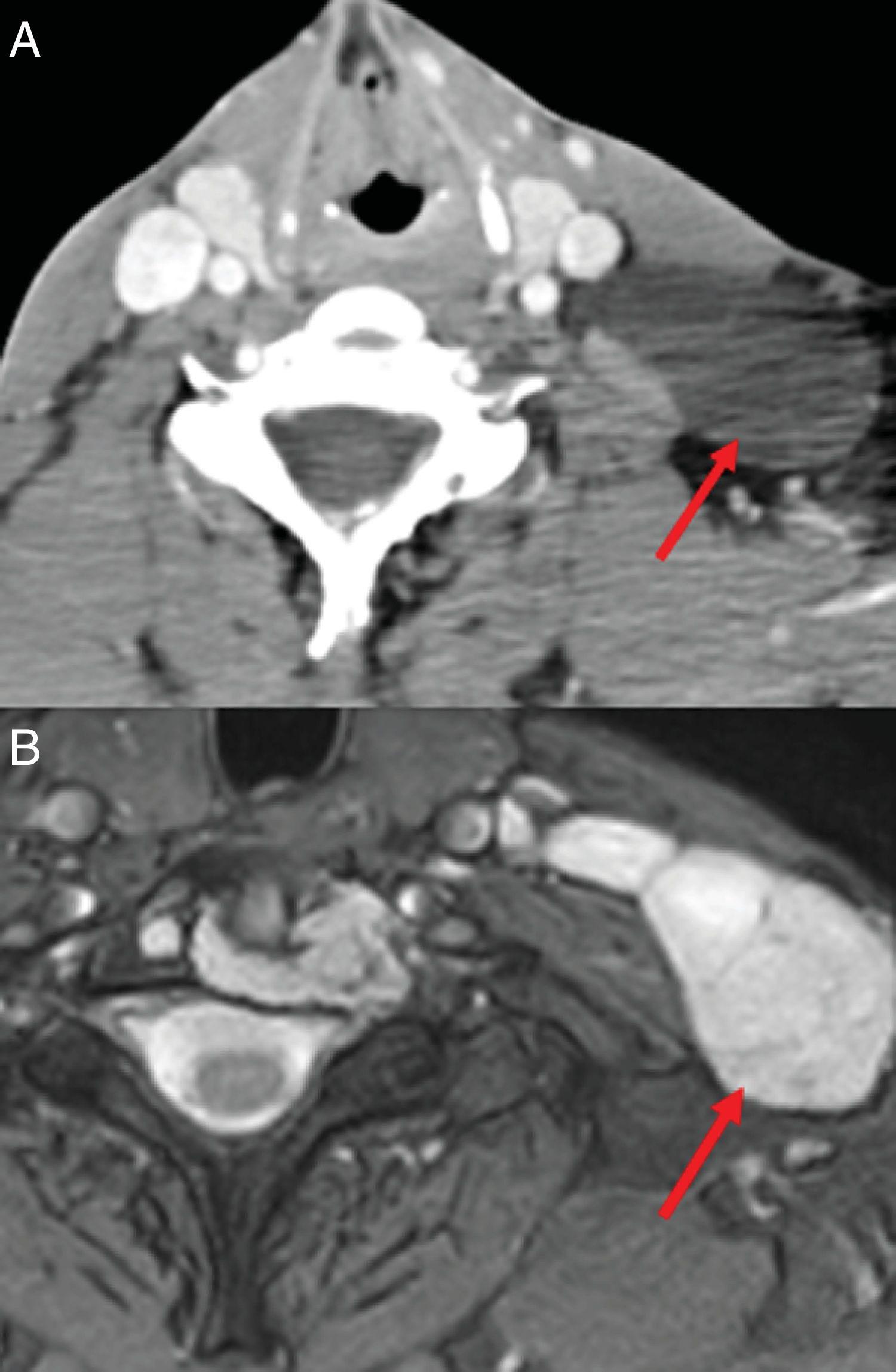 Massive osteolysis in a patient with Gorham-Stout syndrome ...