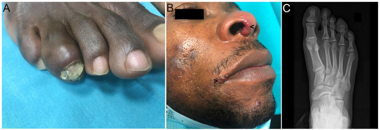 Lupus Pernio Sarcoidosis
