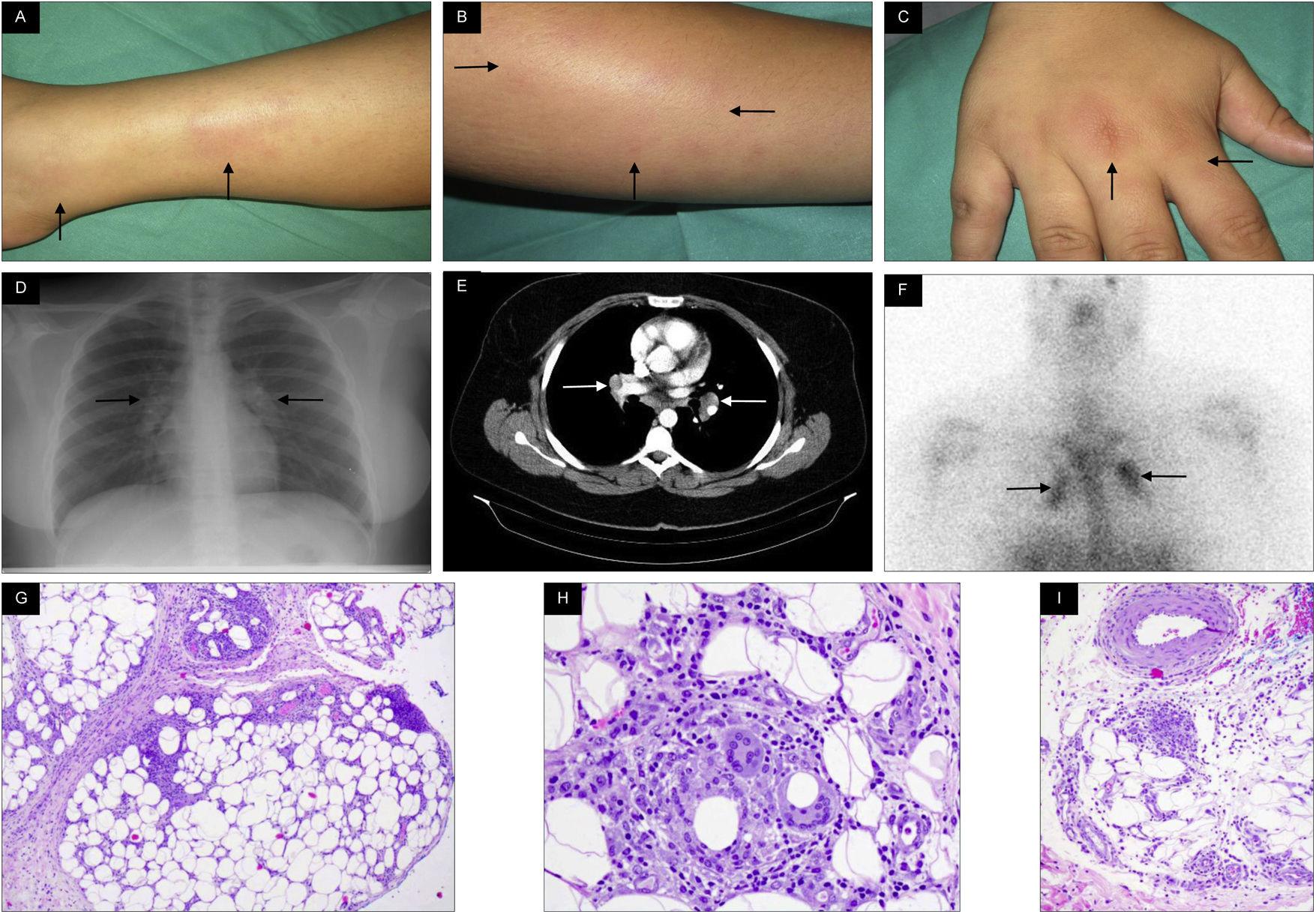 The classic triad of Löfgren’s syndrome in images | Reumatología Clínica