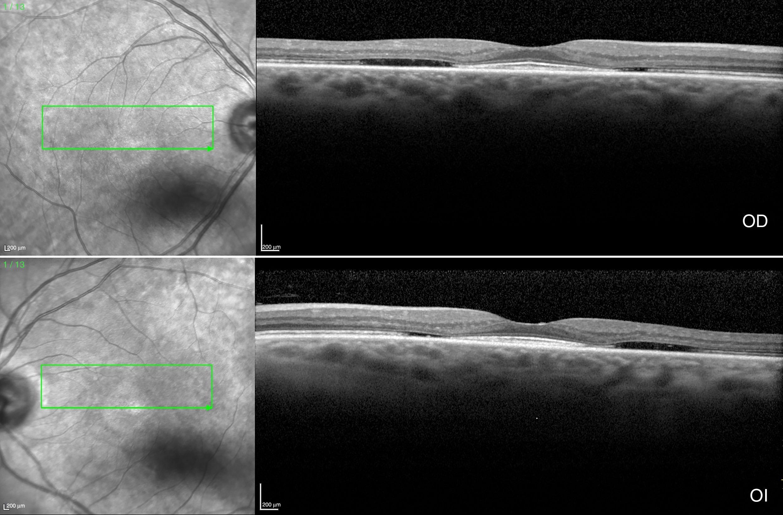 Early macular toxicity following 2 months of hydroxychloroquine therapy ...
