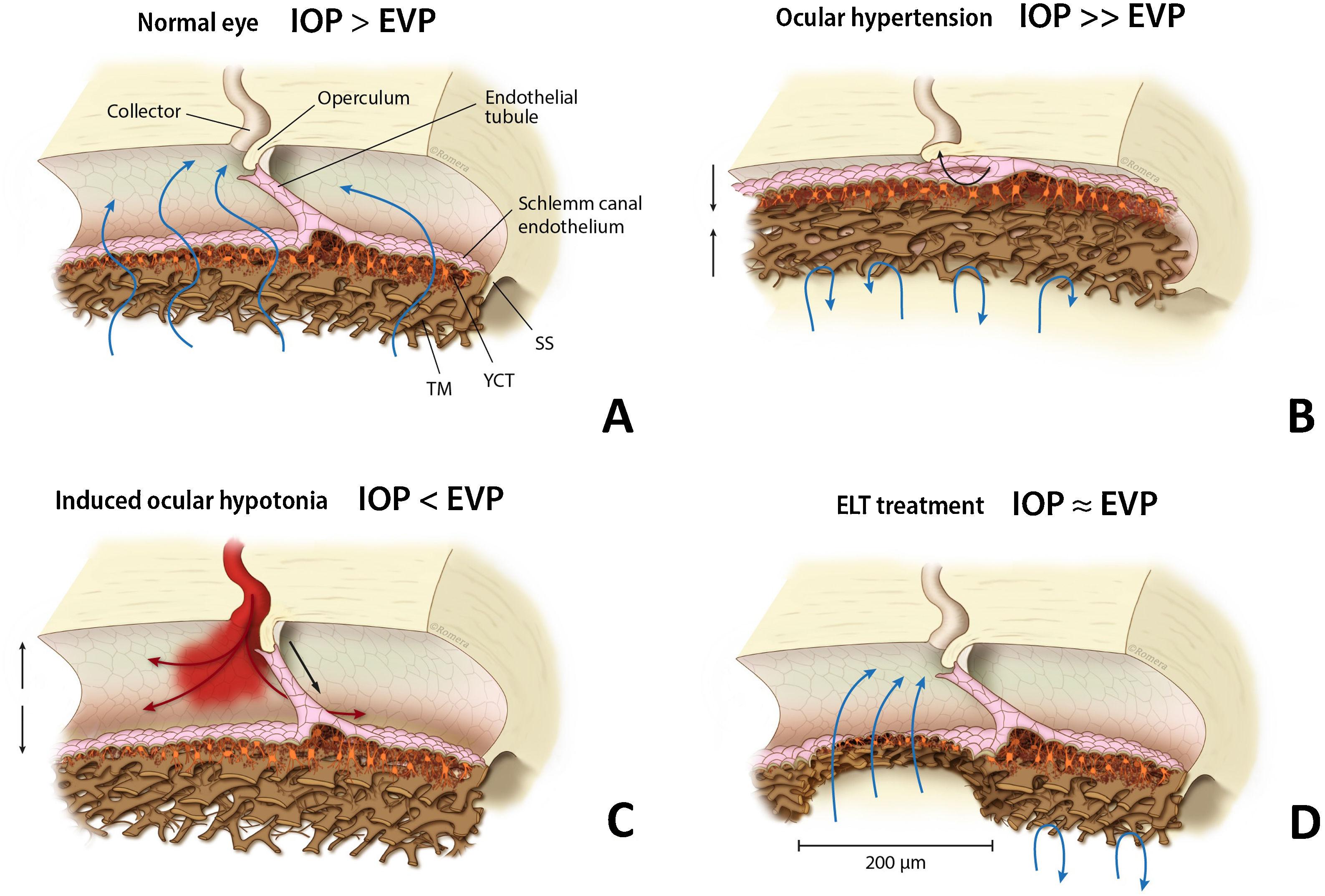 Combined excimer laser trabeculostomy and phacoemulsification: One year ...