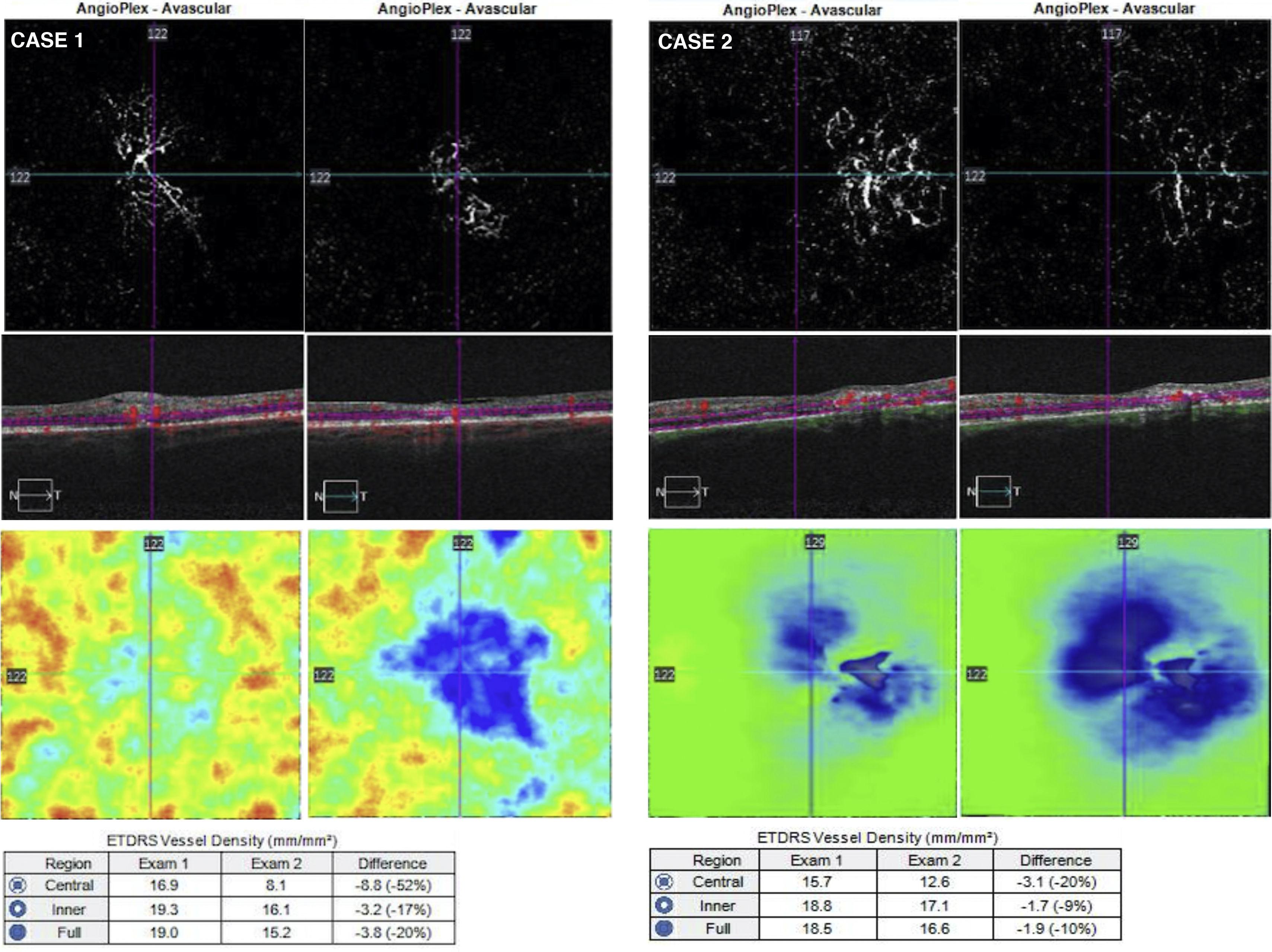 OCT-angiography for diagnosis and response to treatment of subretinal ...