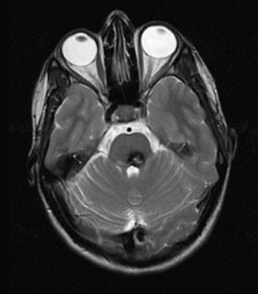 Hypertrophic olivary degeneration secondary to a Guillain–Mollaret ...