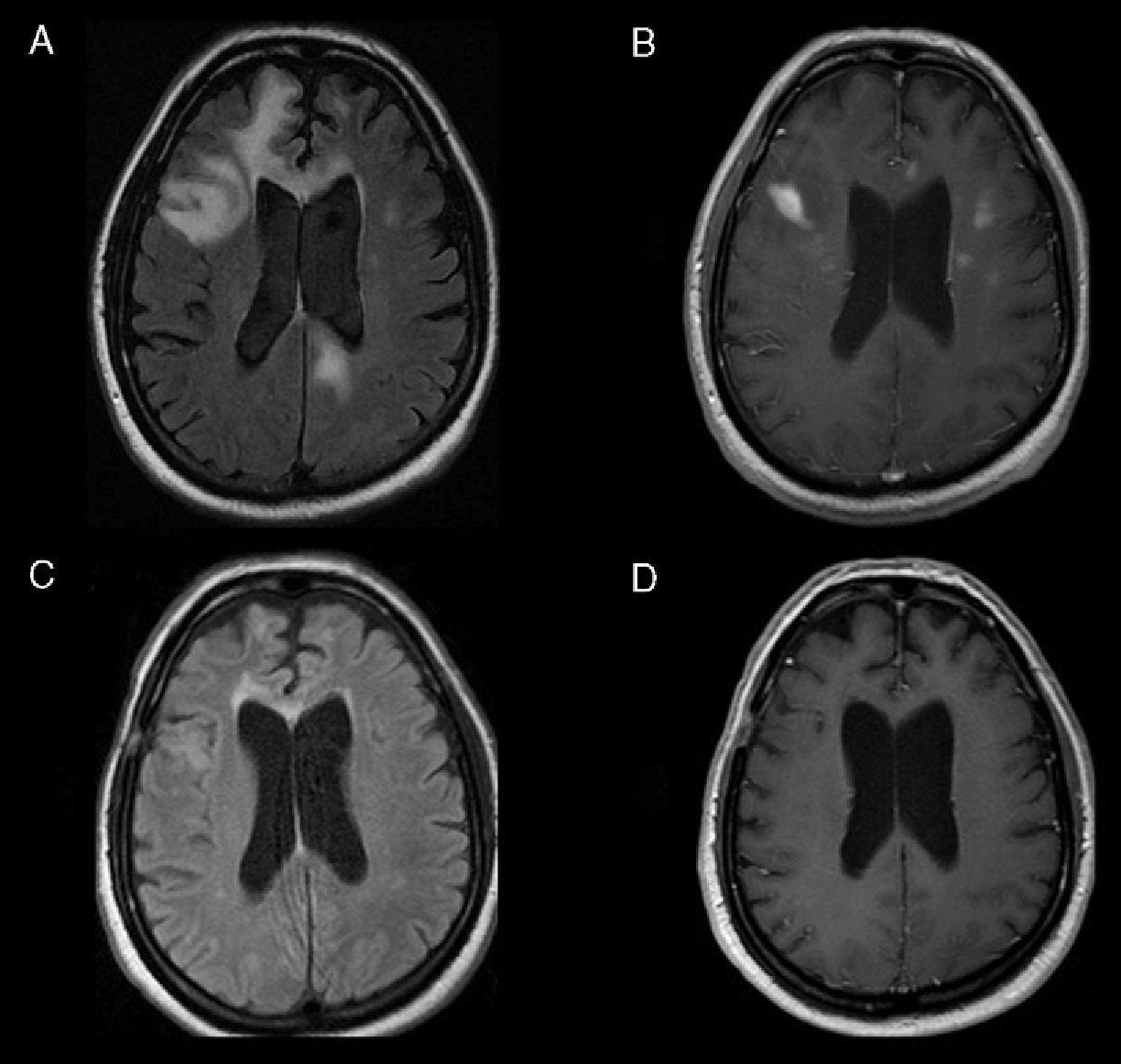 Primary cerebral lymphoma with spontaneous remission | Neurología ...