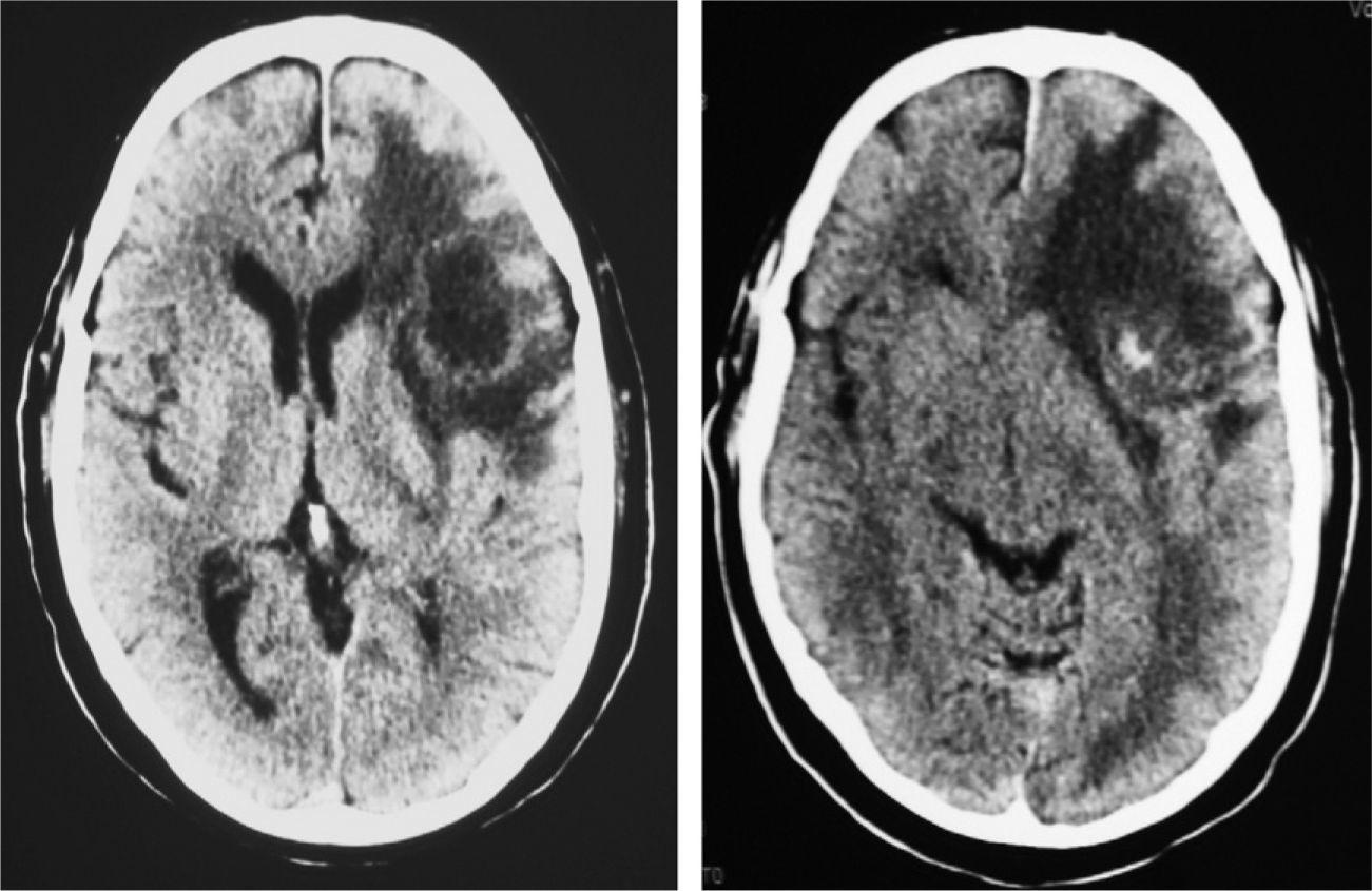 Cerebral abscess due to Rhodococcus equi with pseudotumour presentation ...