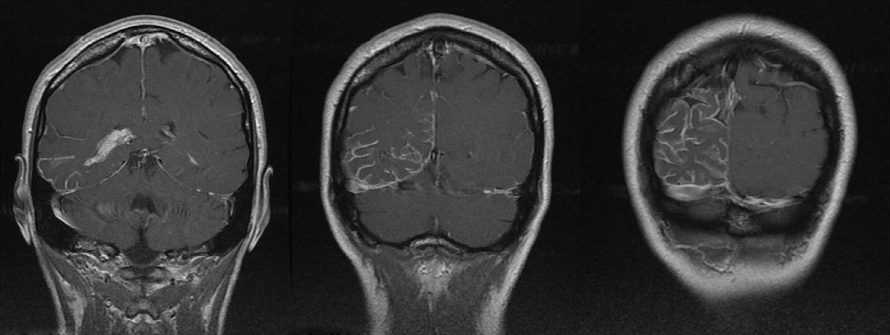 Leptomeningeal Angiomas