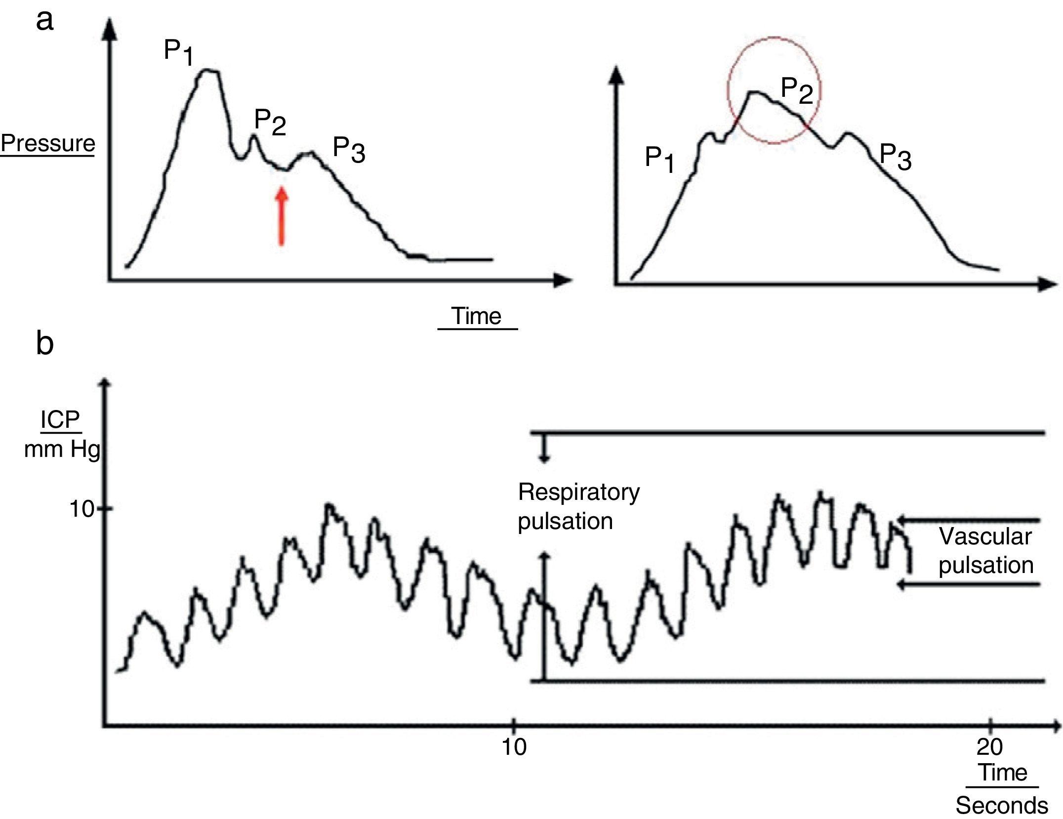 Basic concepts about brain pathophysiology and intracranial pressure ...