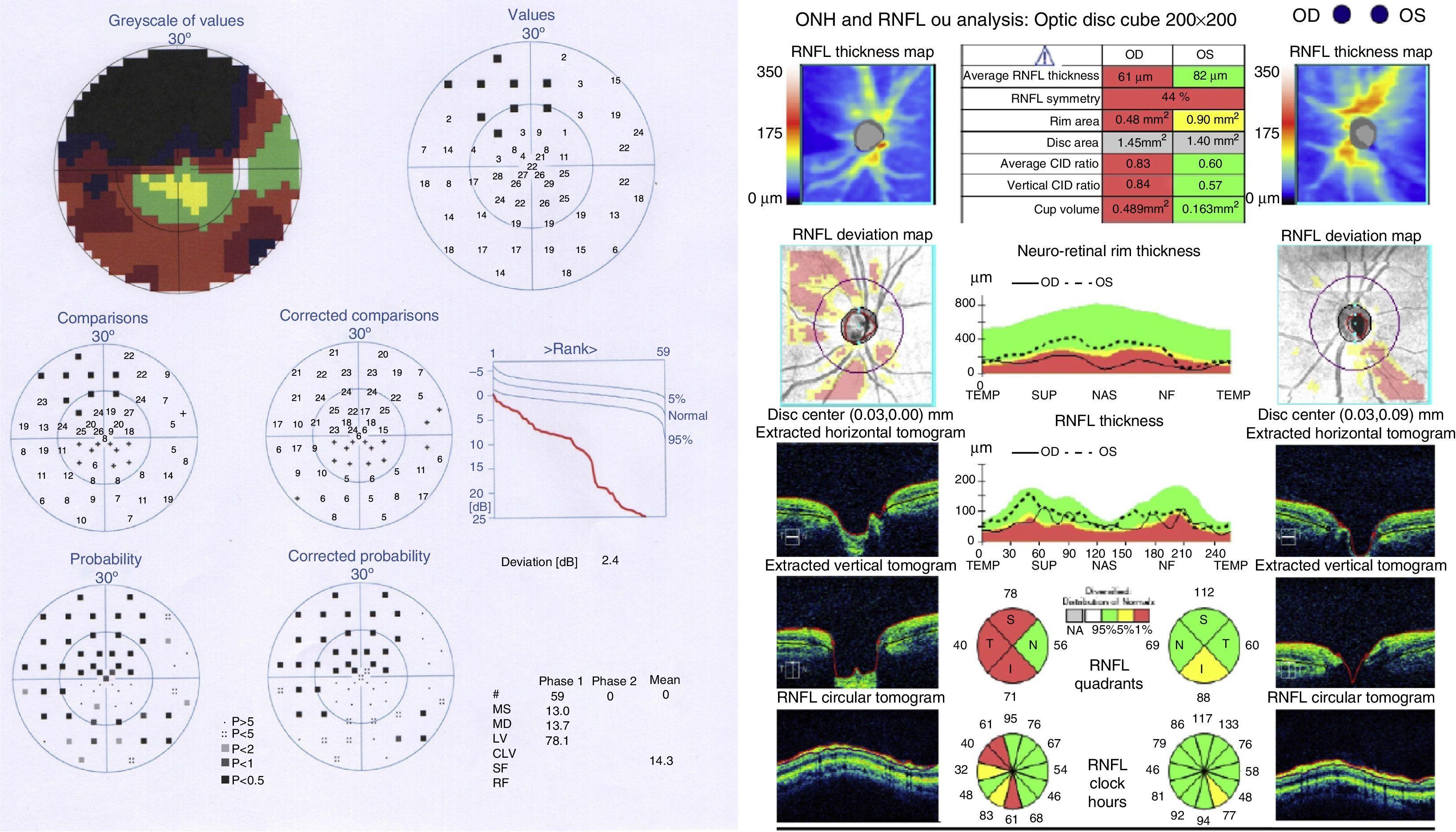 Optic neuropathy after orbital decompression surgery | Neurología ...