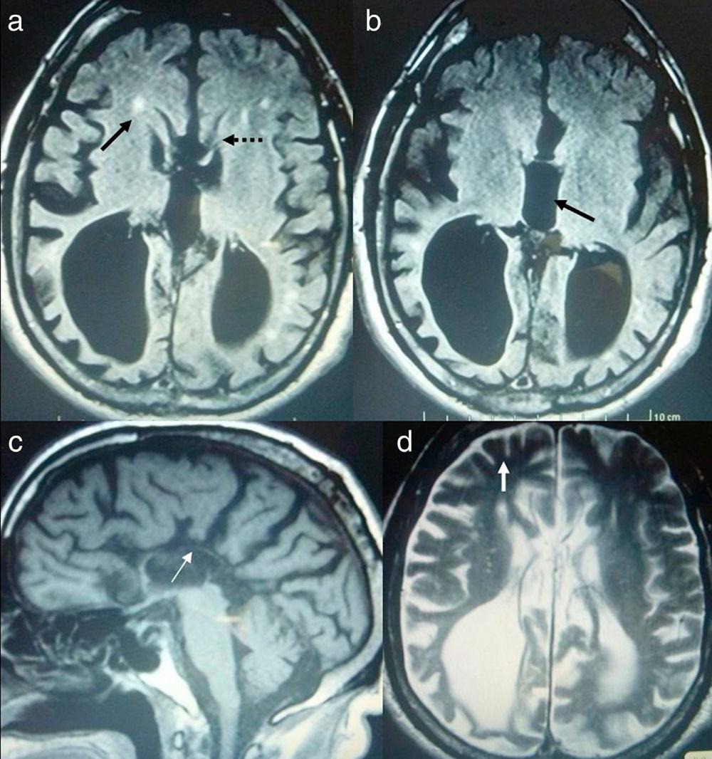 Asymptomatic colpocephaly and partial agenesis of corpus callosum ...
