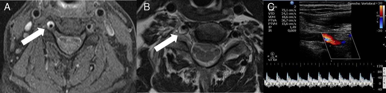 Compressive C5-C6 radiculopathy secondary to spontaneous vertebral ...