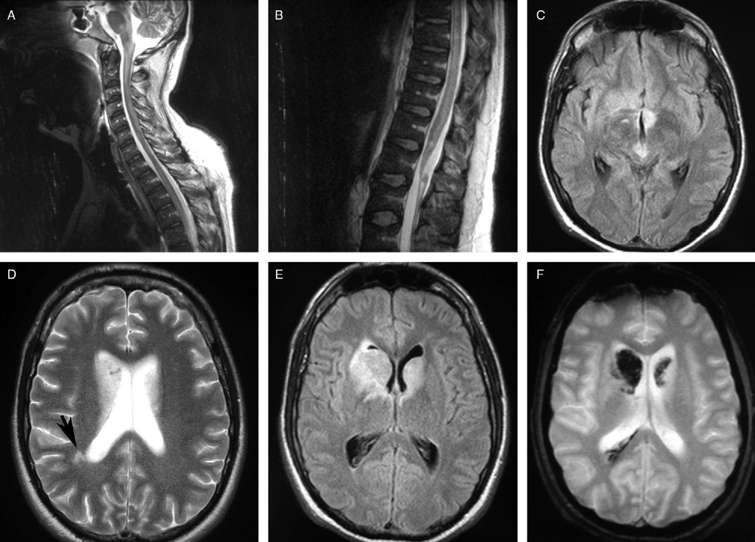 Acute disseminated encephalomyelitis as a complication of systemic ...