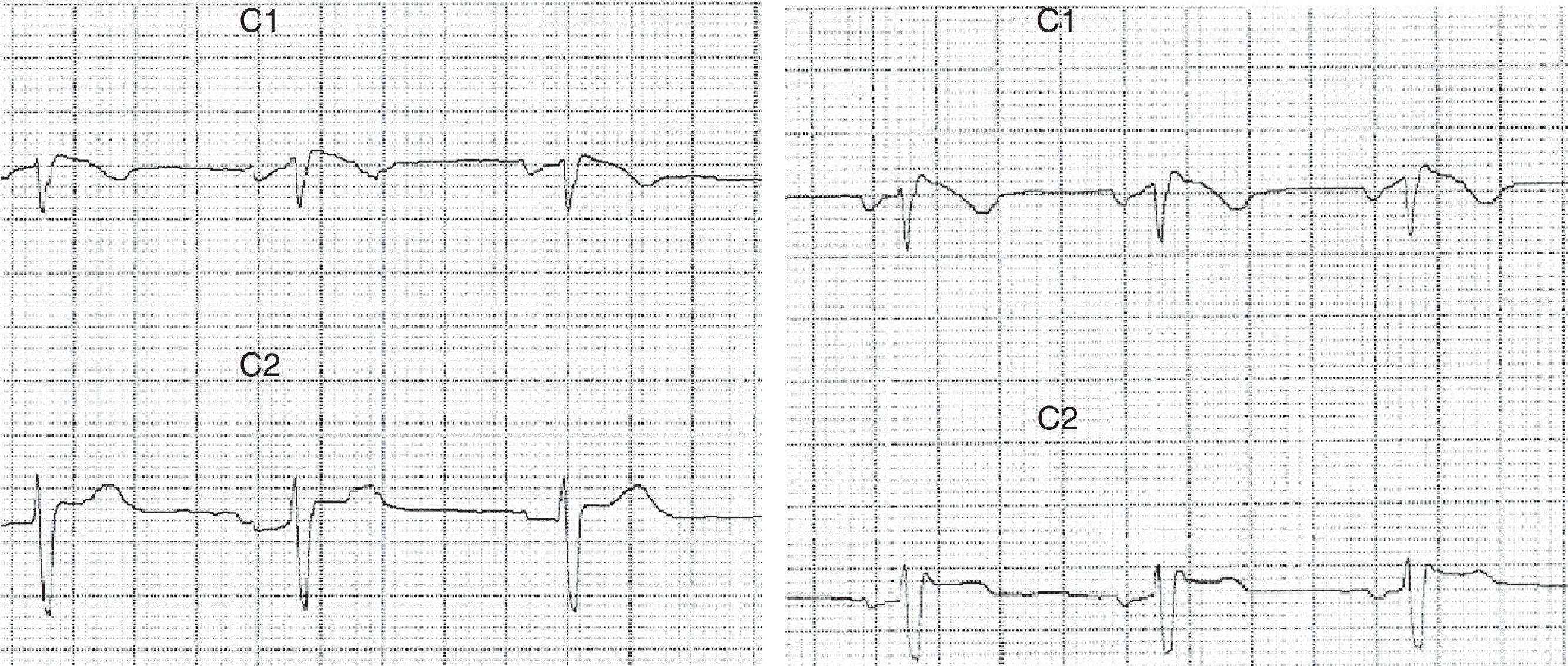 Epilepsy and Brugada syndrome | Neurología (English Edition)