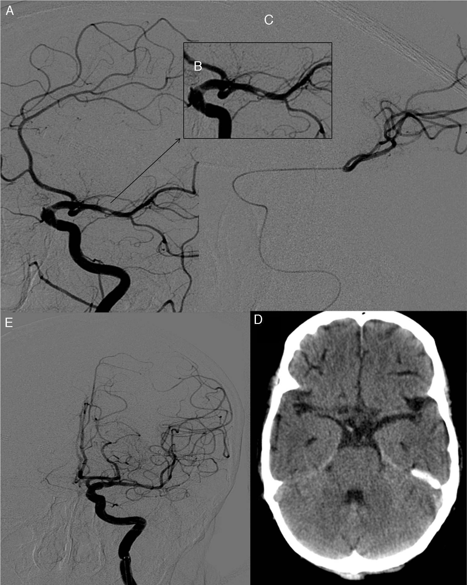 Mechanical thrombectomy during ischaemic stroke due to a calcified ...
