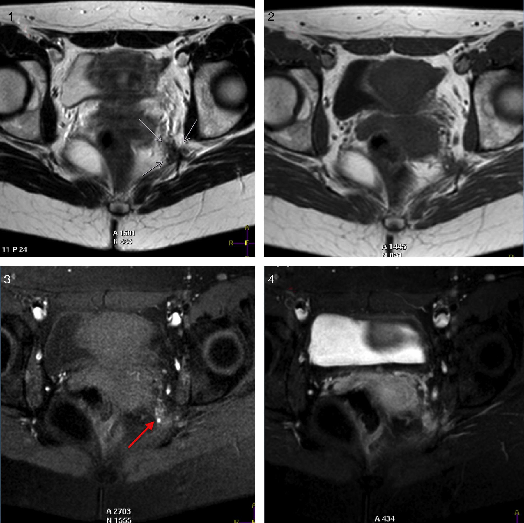 Alcock canal syndrome secondary to endometrial infiltration ...