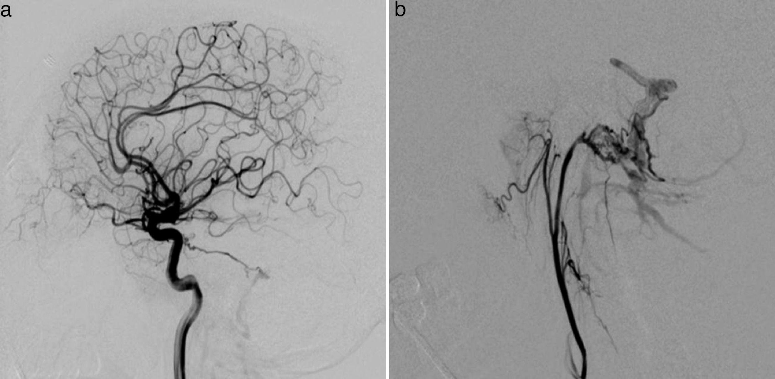 Recurrent dural arteriovenous fistulas in a patient with Behçet's ...