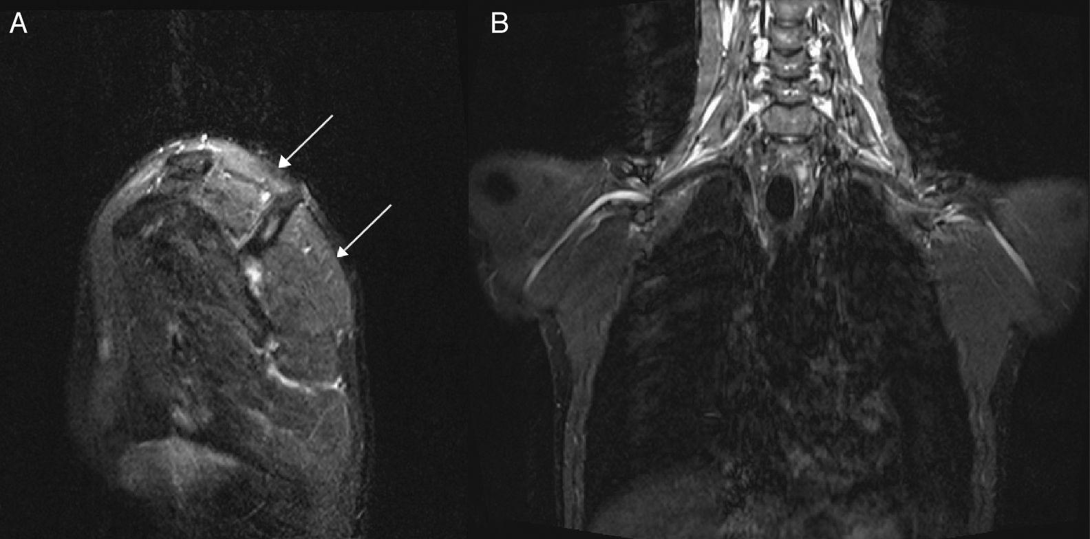 Hereditary neuropathy with liability to pressure palsy presenting as a ...