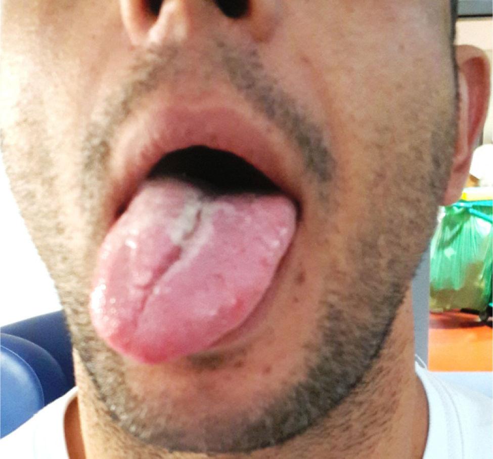 Tongue Deviation