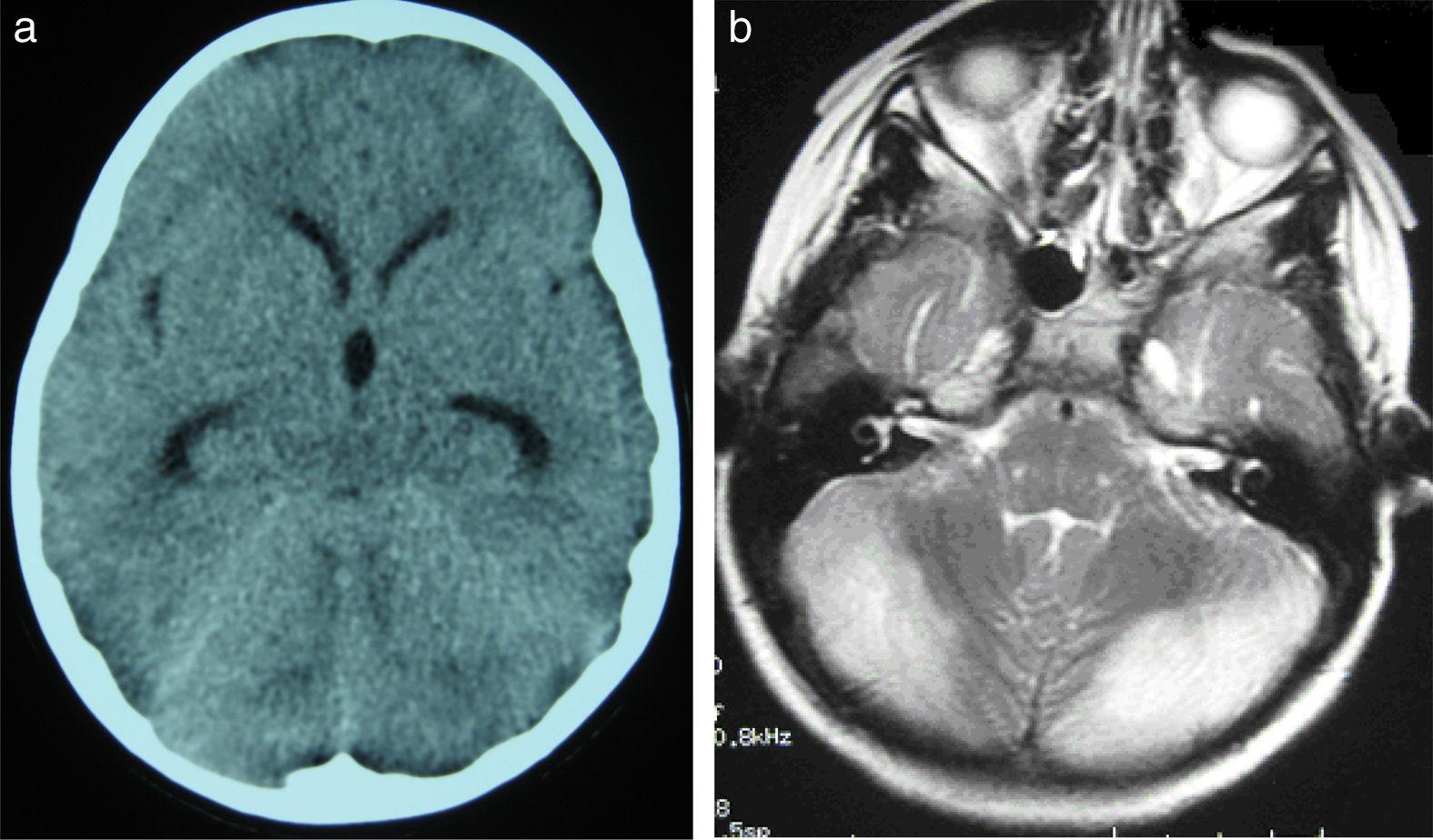 Acute cerebellitis in paediatric patients: Our experience | Neurología ...