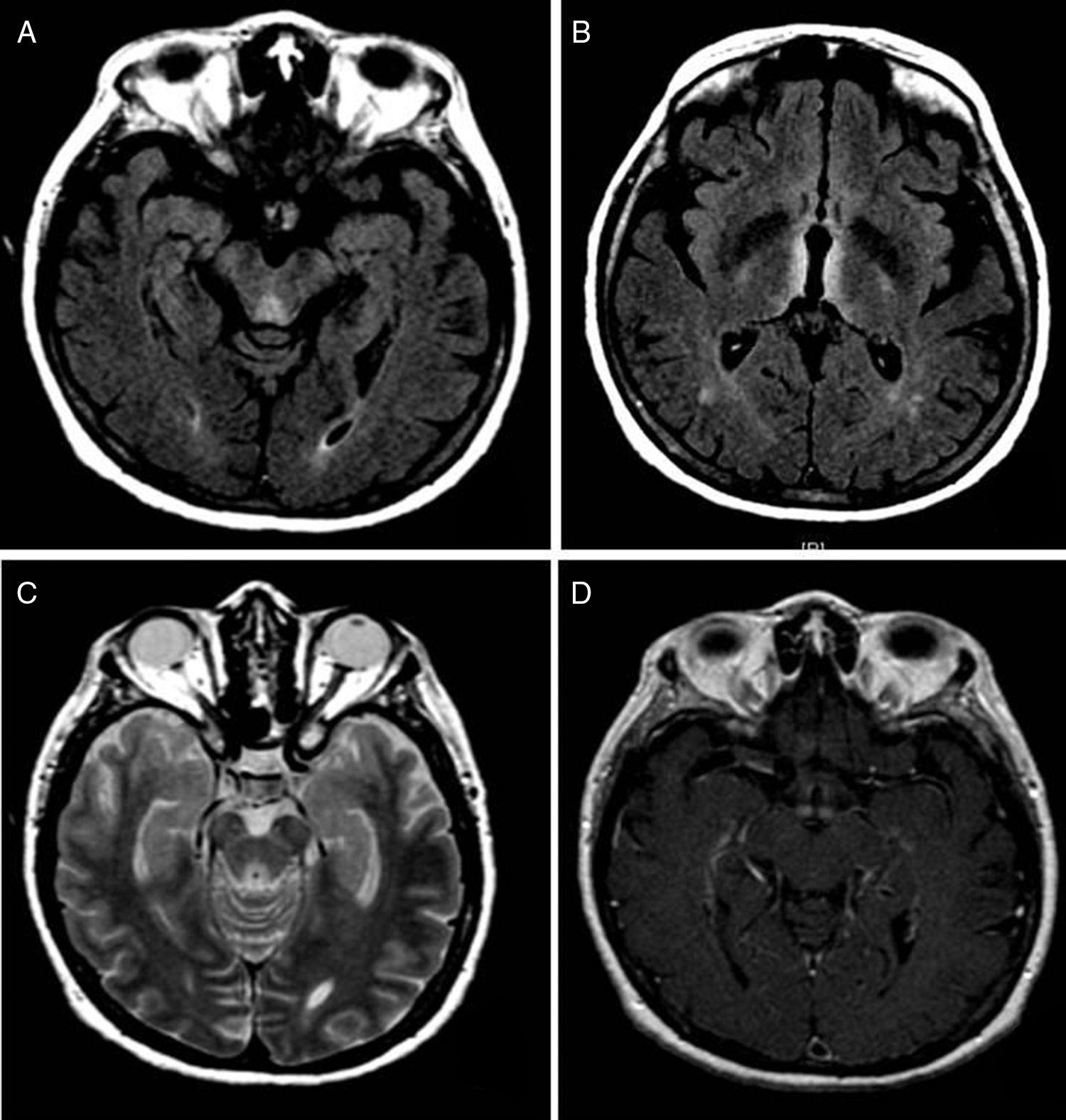 Scurvy and Wernicke's encephalopathy: An underdiagnosed association ...