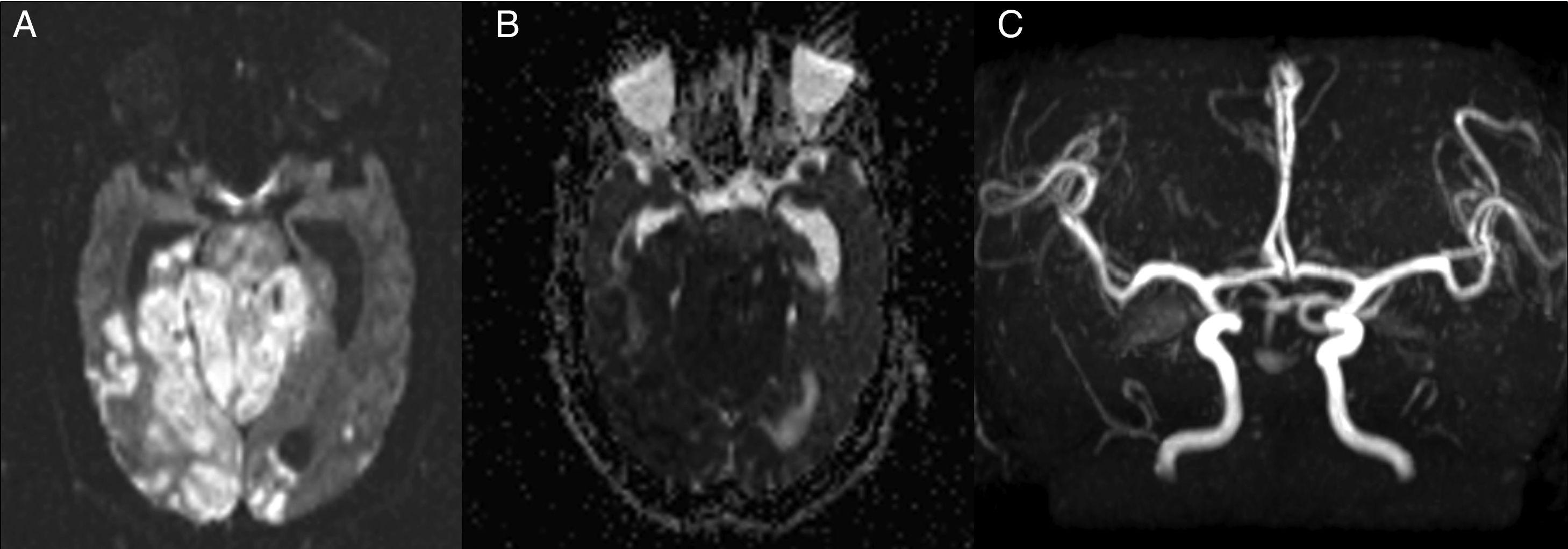 Basilar artery thrombosis caused by vertebral dissection secondary to ...