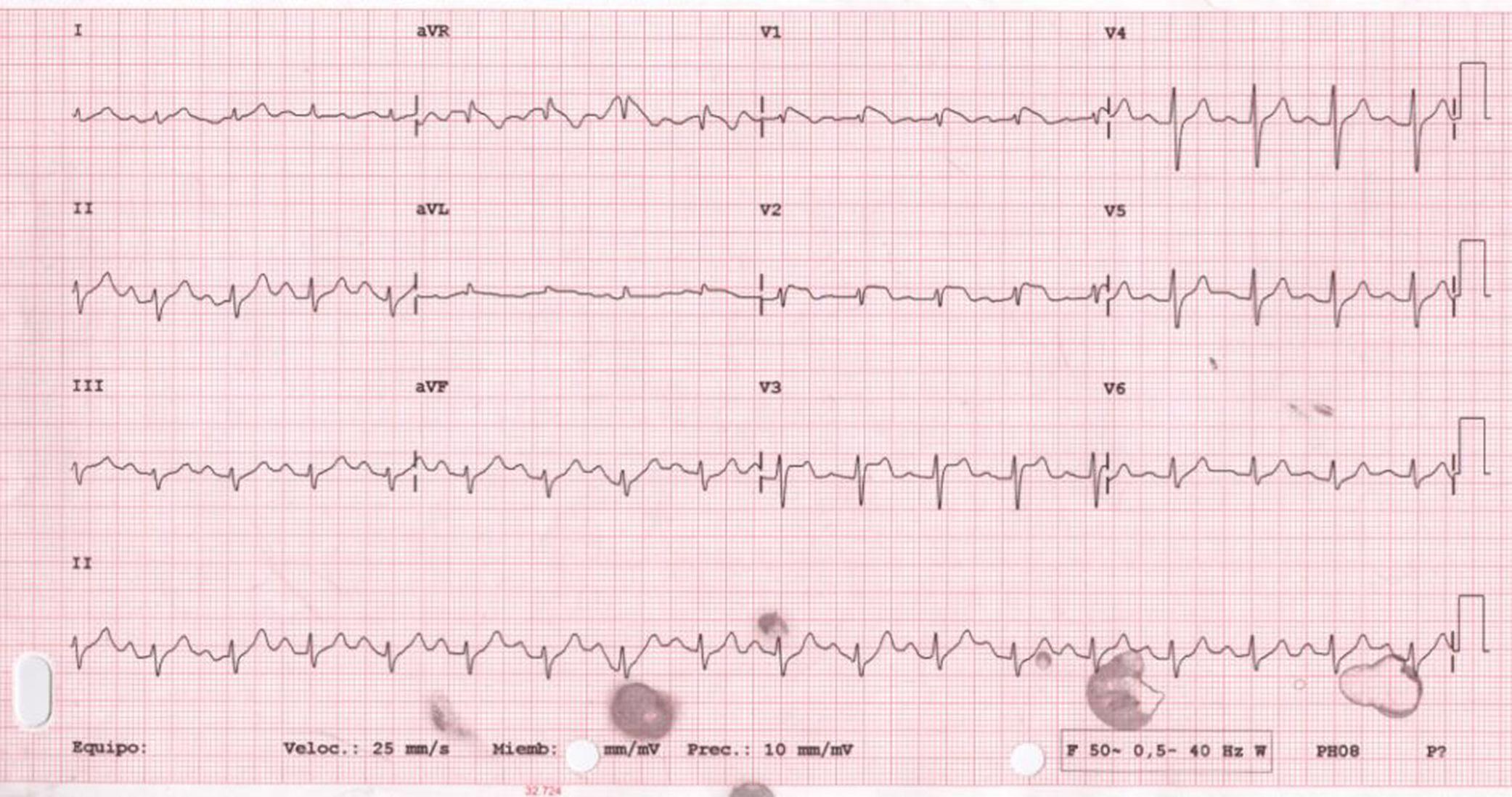 The Brugada pattern in a patient treated with amitriptyline ...
