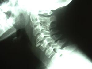 Intervertebral disc calcification as a cause of painful torticollis in ...