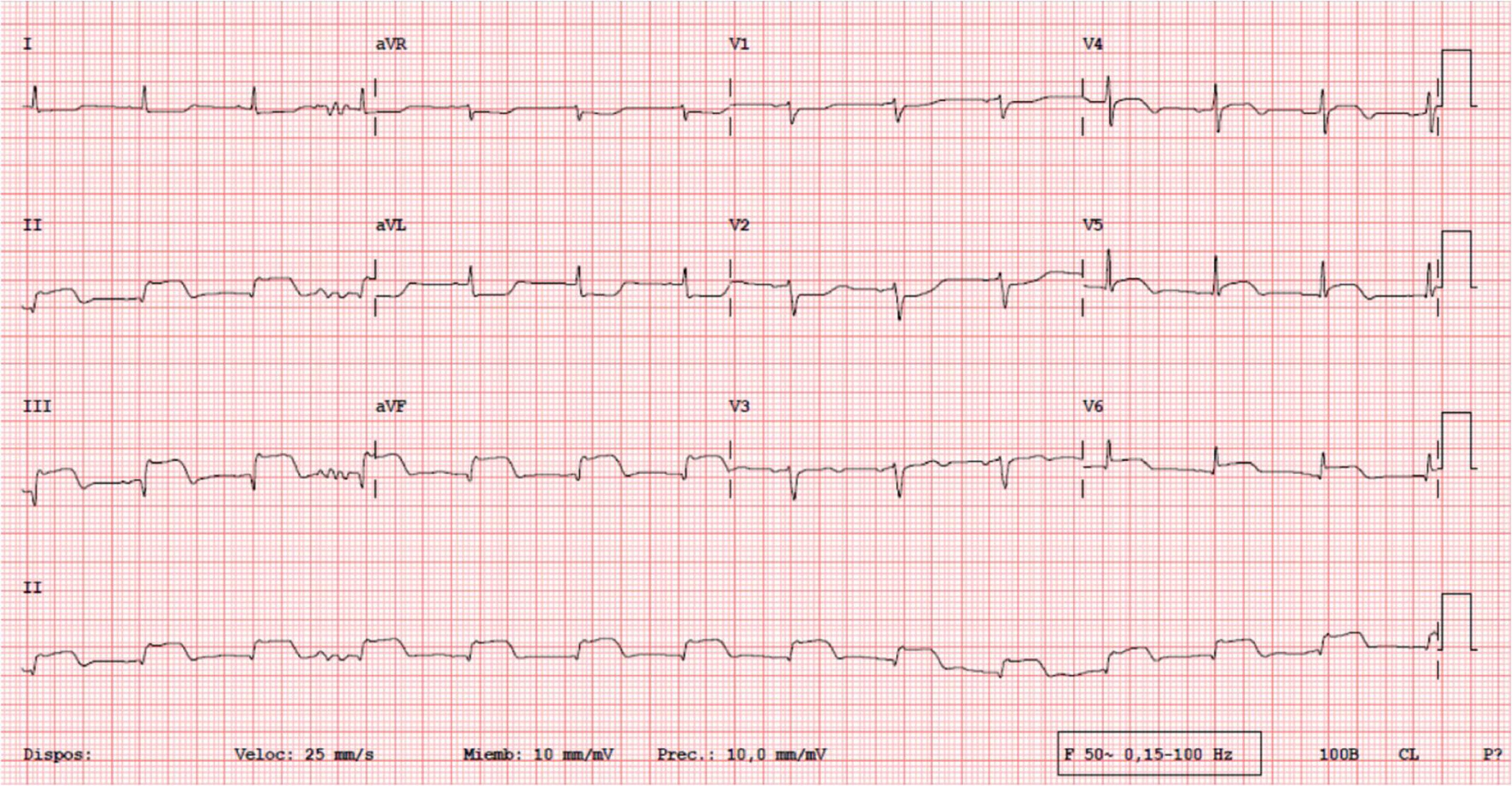 Cardiac cephalalgia: when myocardial ischaemia reaches the neurologist ...