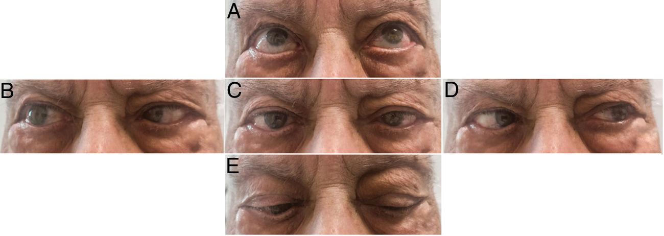 Isolated bilateral abducens nerve palsy secondary to clivus metastasis ...