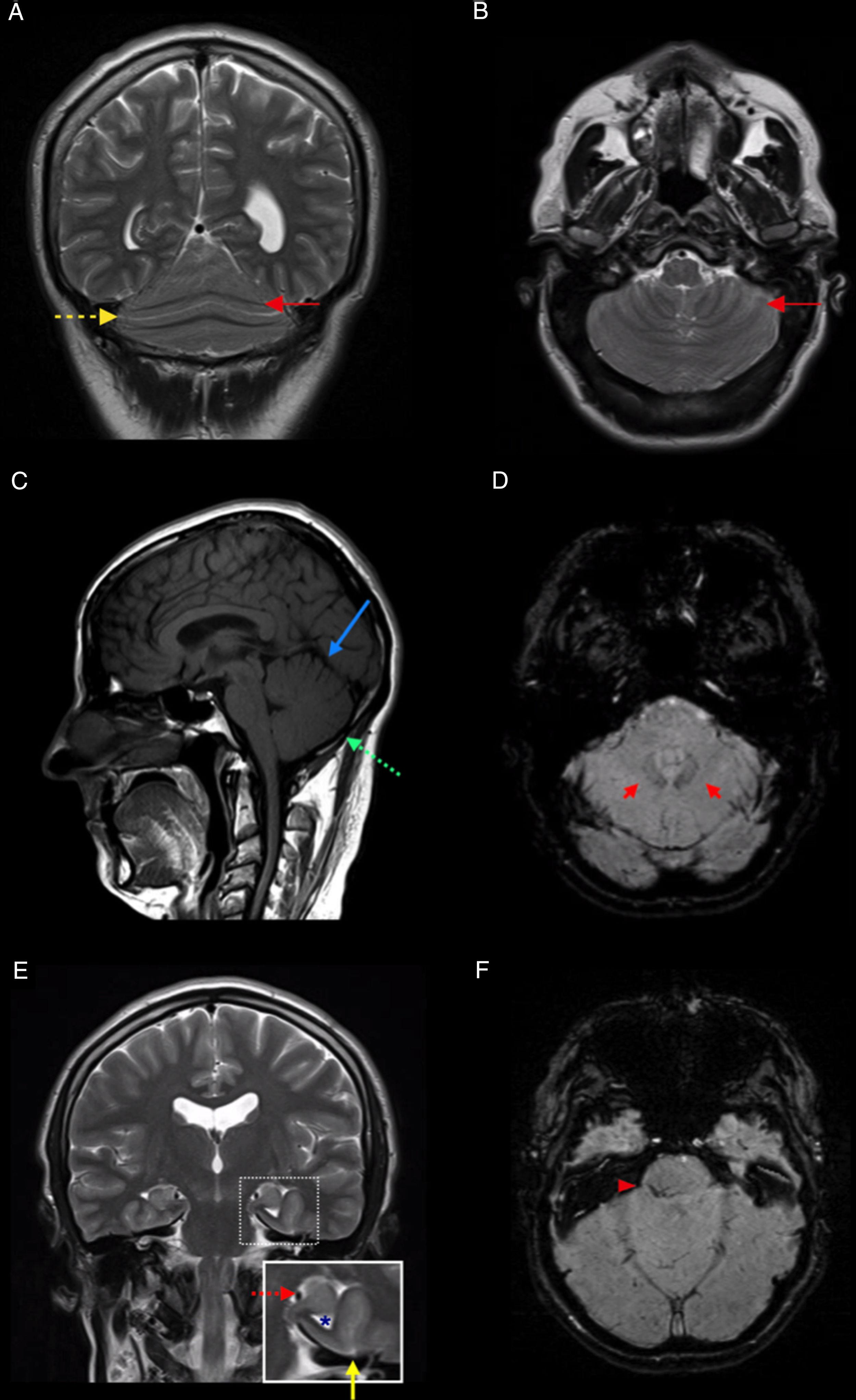 Adult rhombencephalosynapsis: an unusual presentation of an infrequent ...