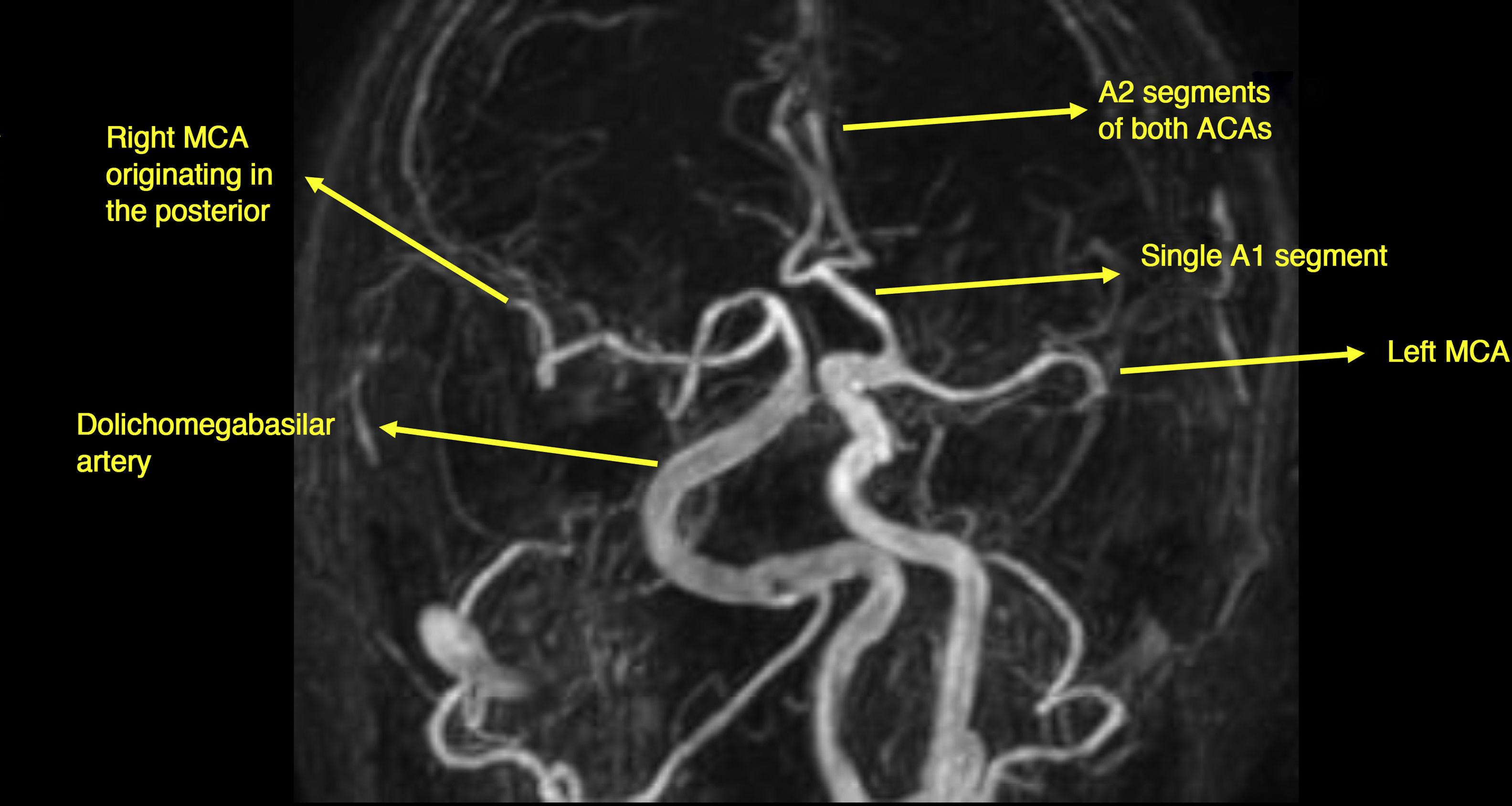 Circle Of Willis Mri