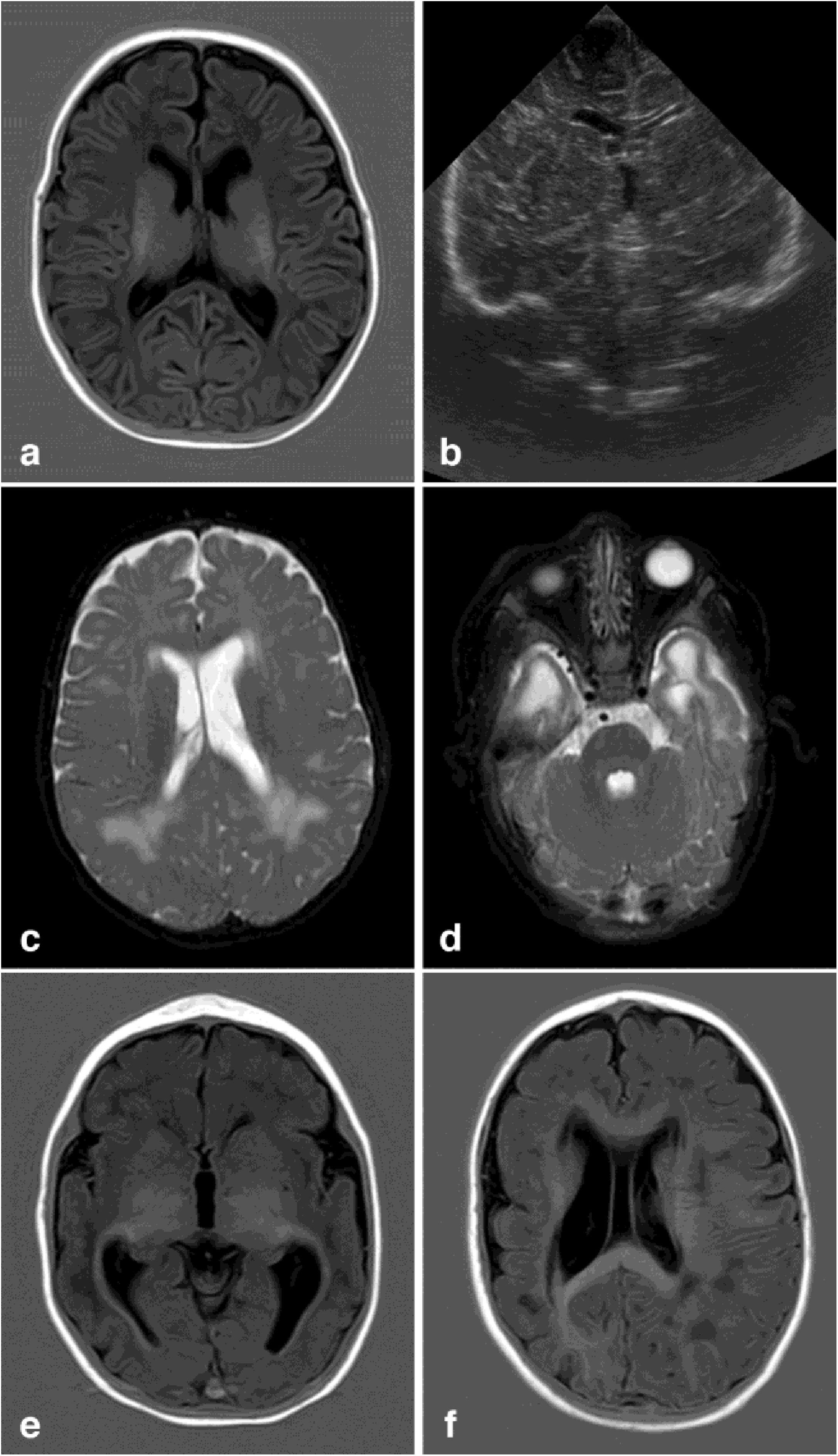 Association between neuroimaging findings and neurological sequelae in ...