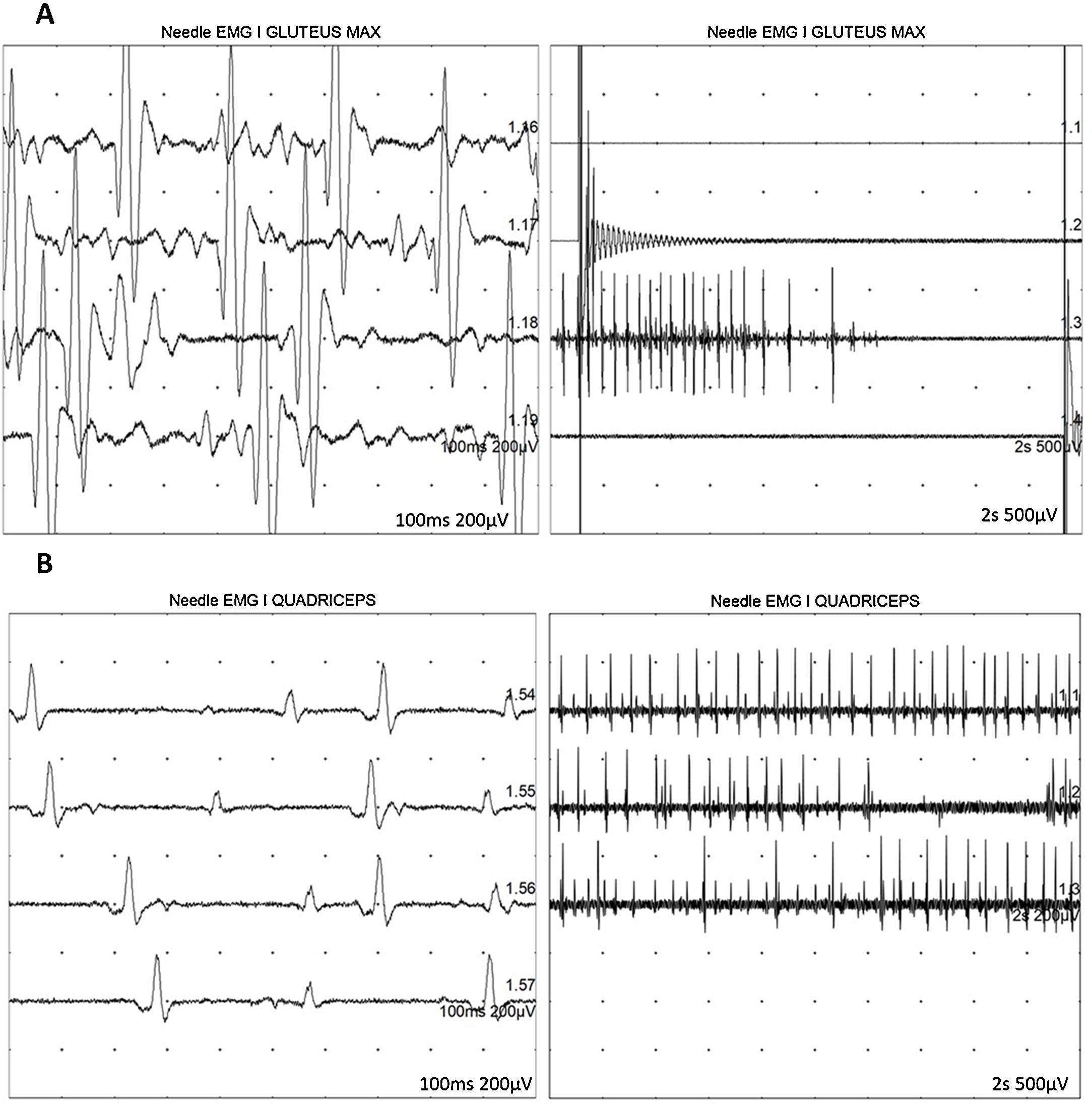 DYNC1H1 de novo mutation, spinal muscular atrophy and attention ...