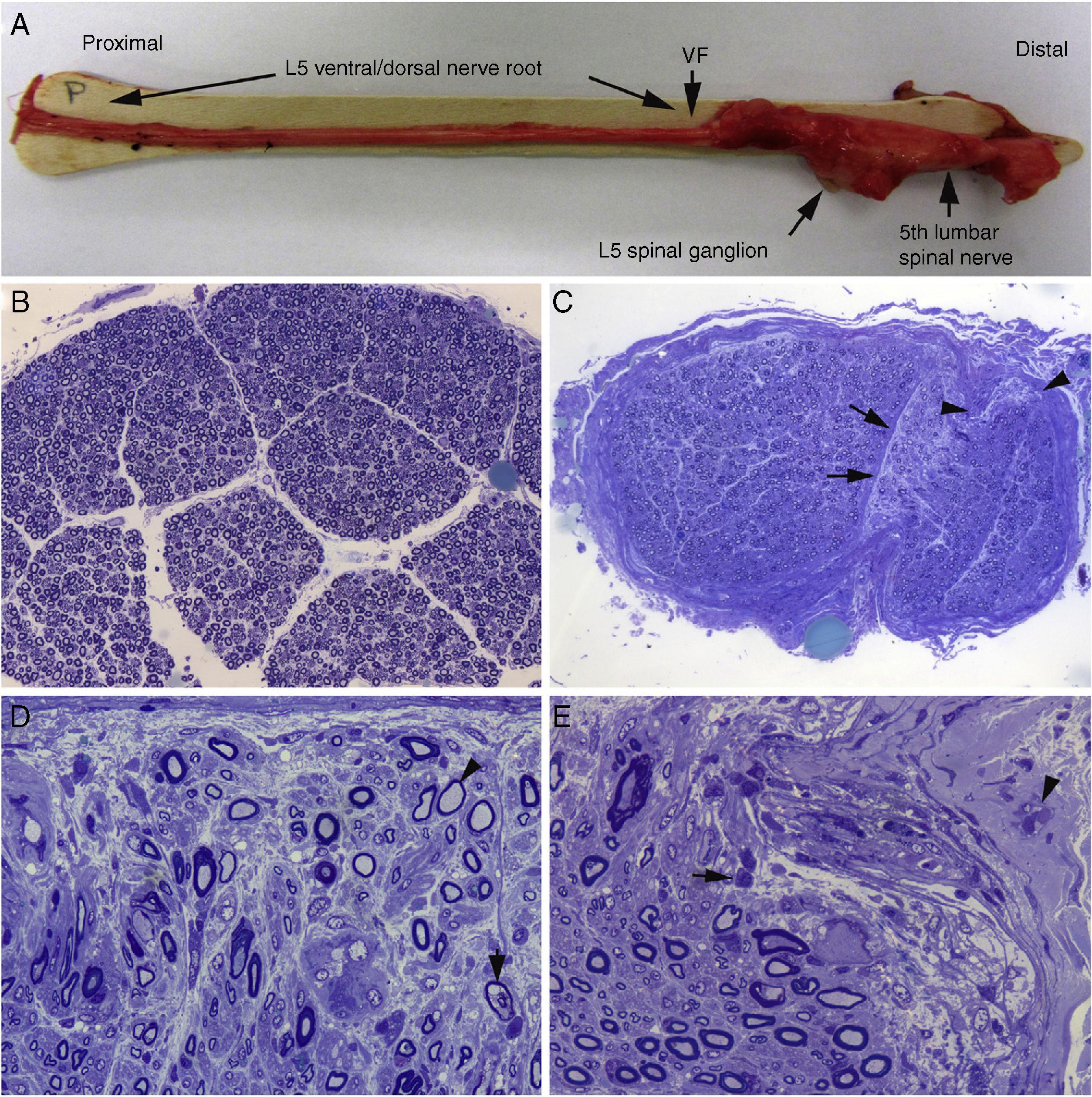 Porencephalic Cyst Pathology