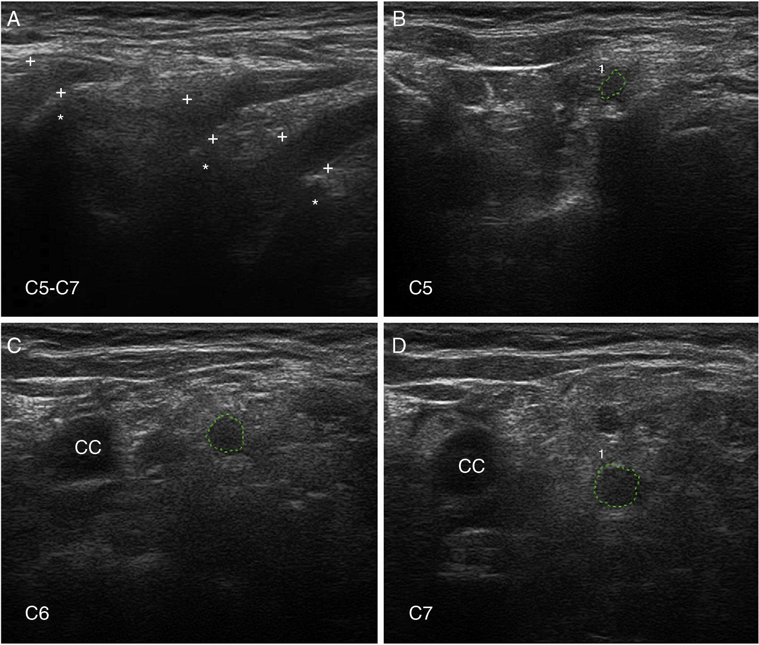 Axonal pathology in early stages of Guillain-Barré syndrome ...