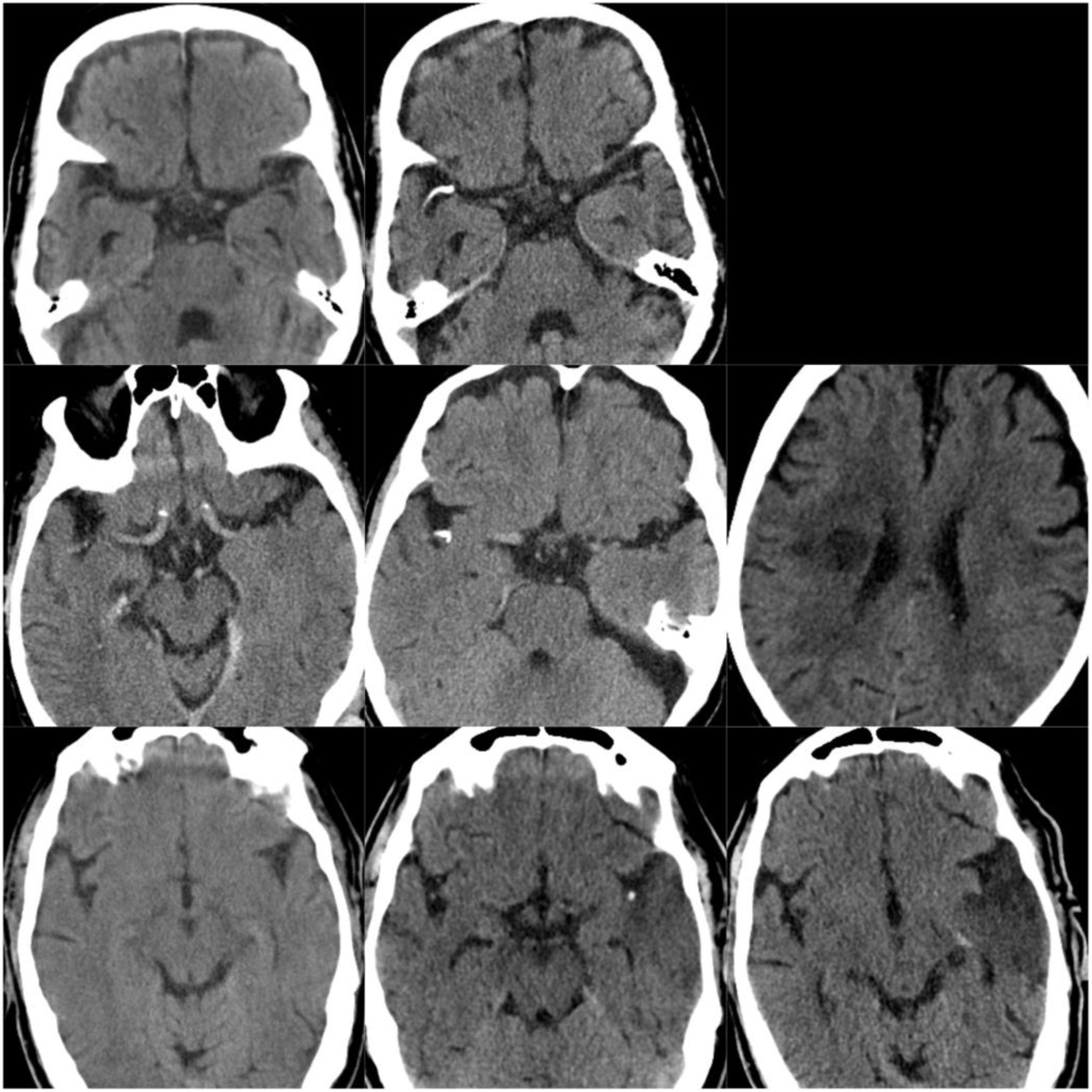 Calcified cerebral embolism: a 9-case series and review of the ...