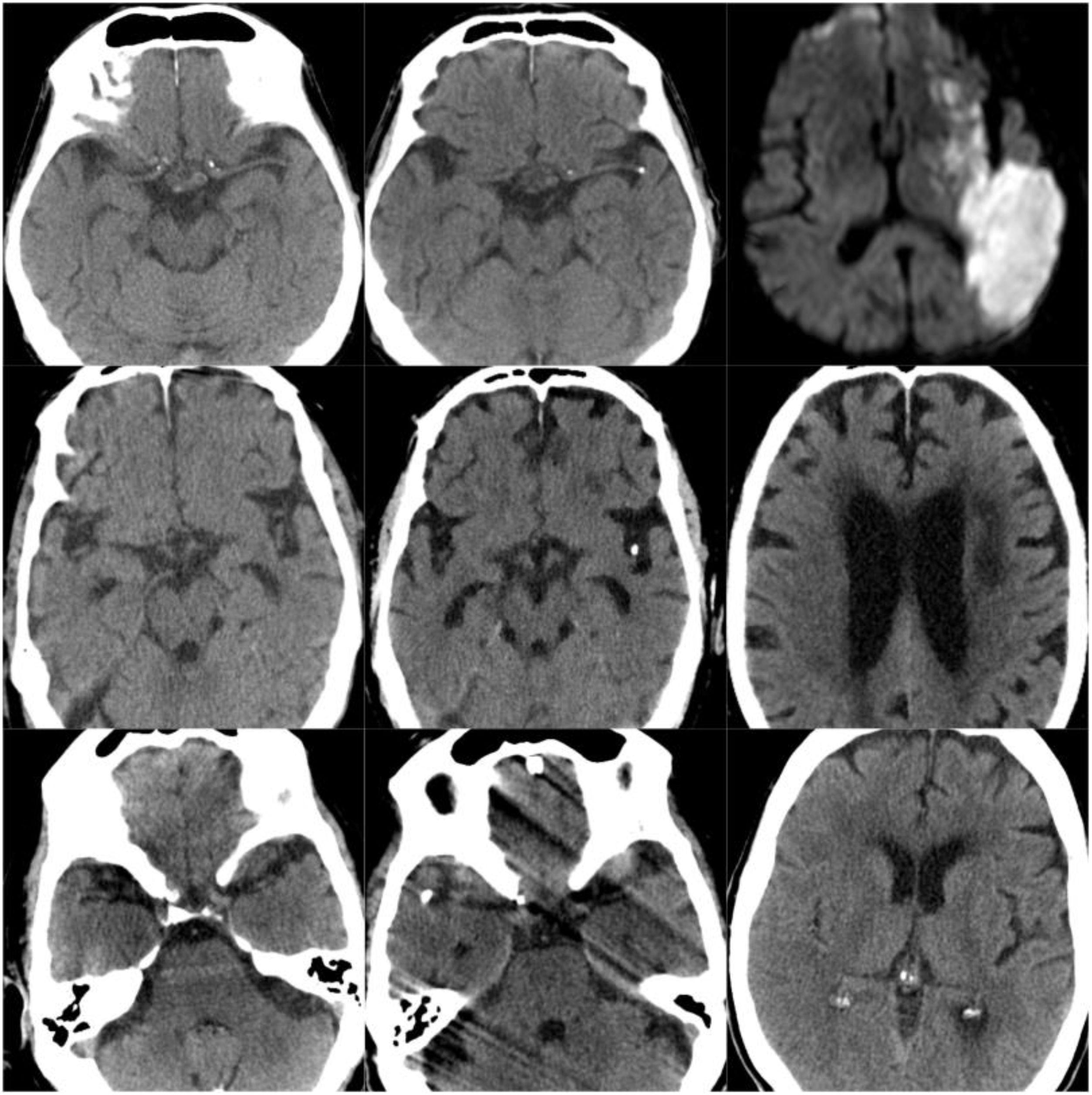 Calcified cerebral embolism: a 9-case series and review of the ...