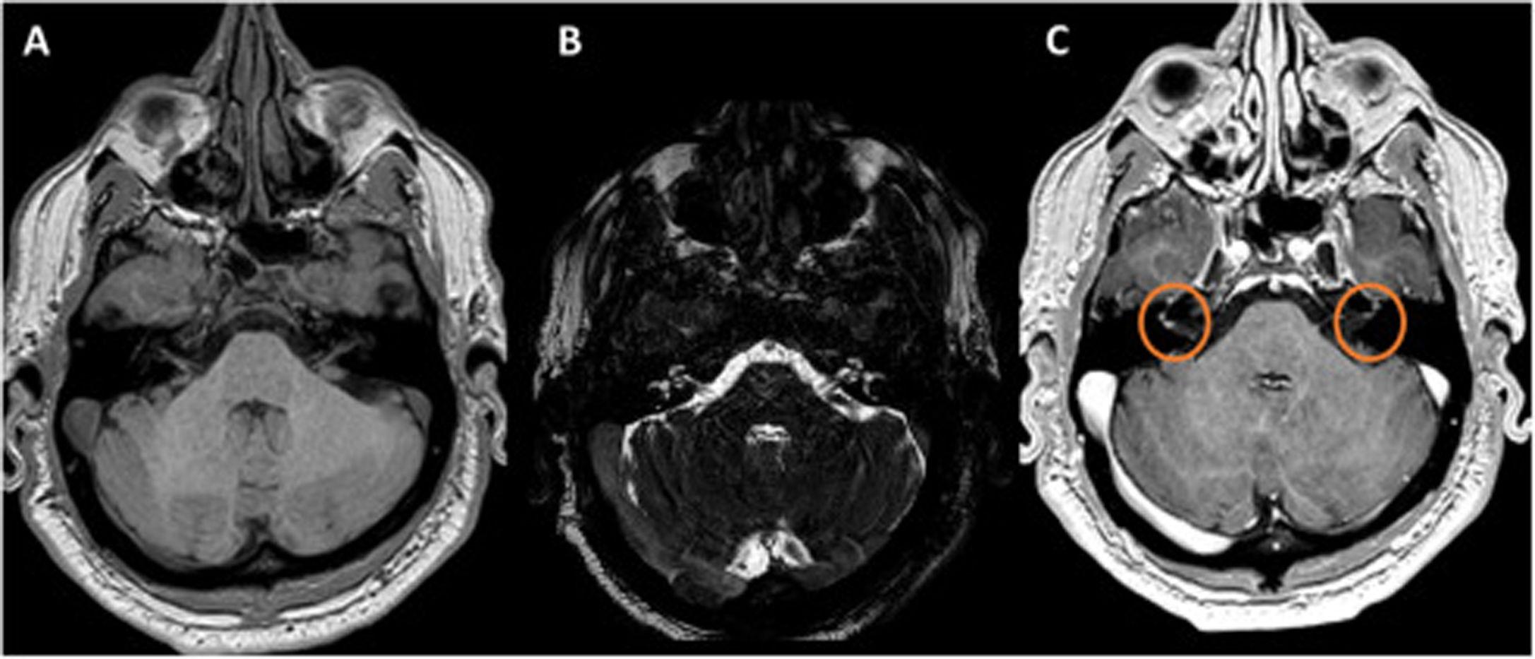 Usefulness of magnetic resonance imaging in the diagnosis of Guillain ...