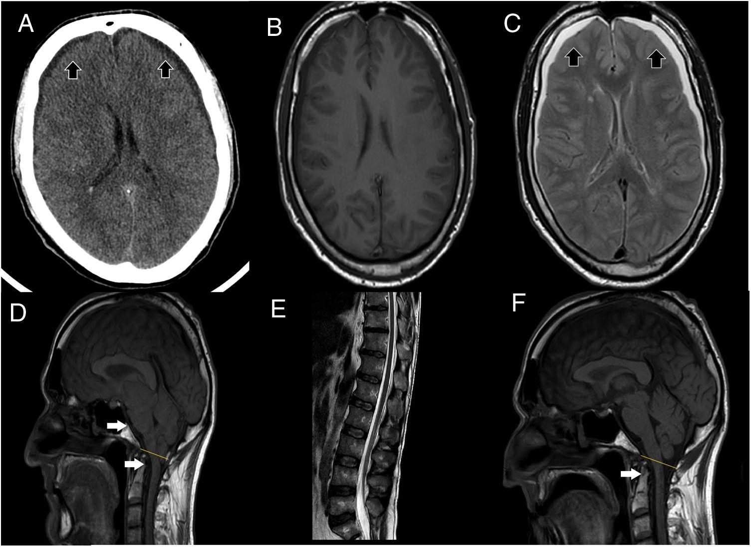 Brain sagging syndrome, a potentially reversible cause of subacute ...