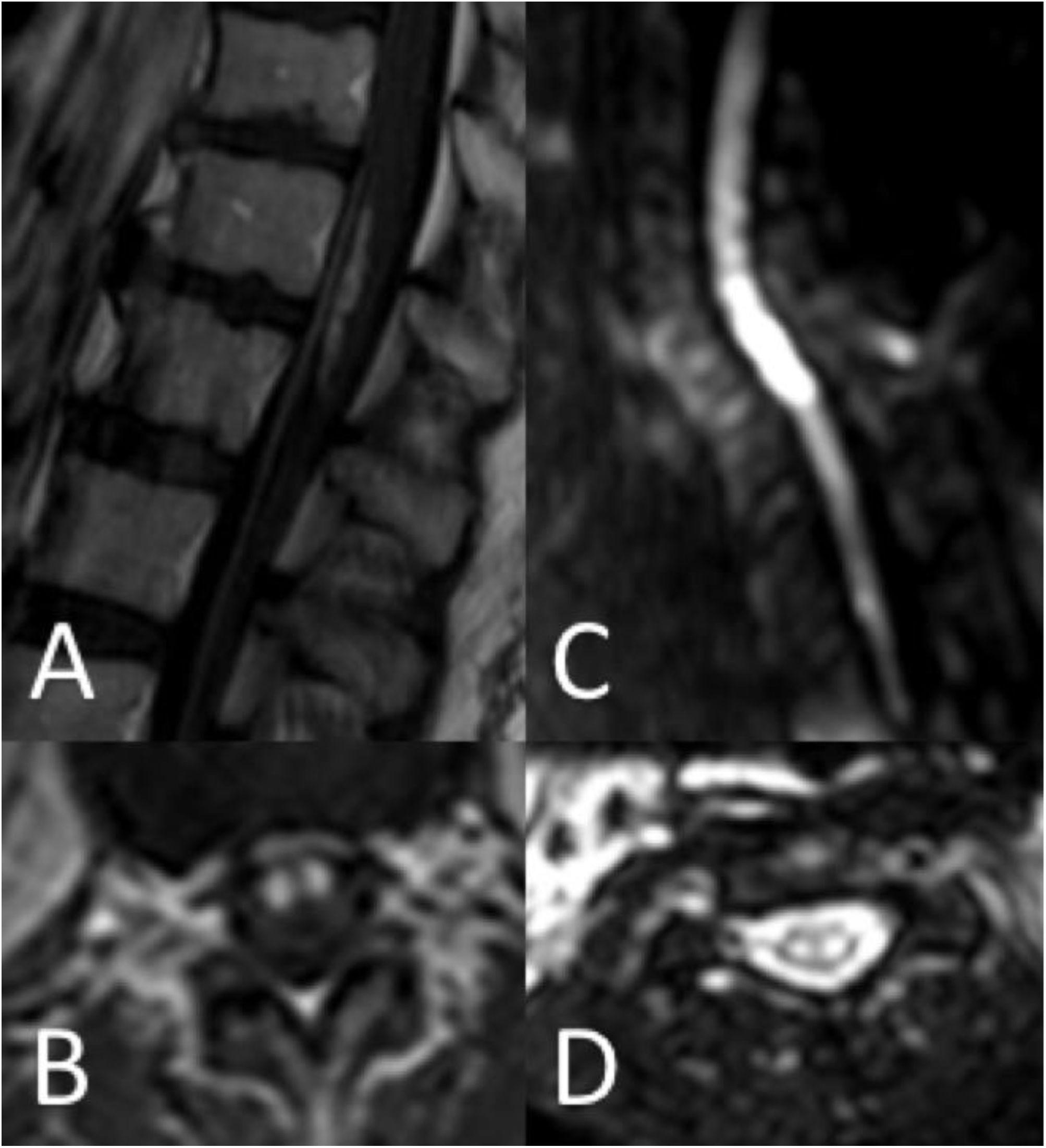 Spinal cord infarction: aetiology, imaging findings, and prognostic ...
