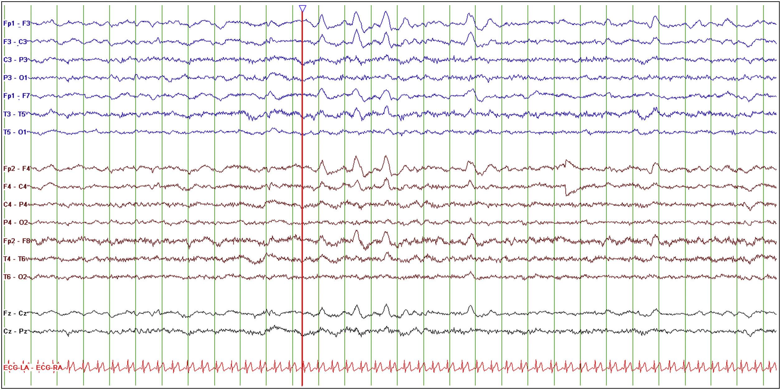 Anti-NMDA-R encephalitis post-COVID-19: Case report and proposed ...